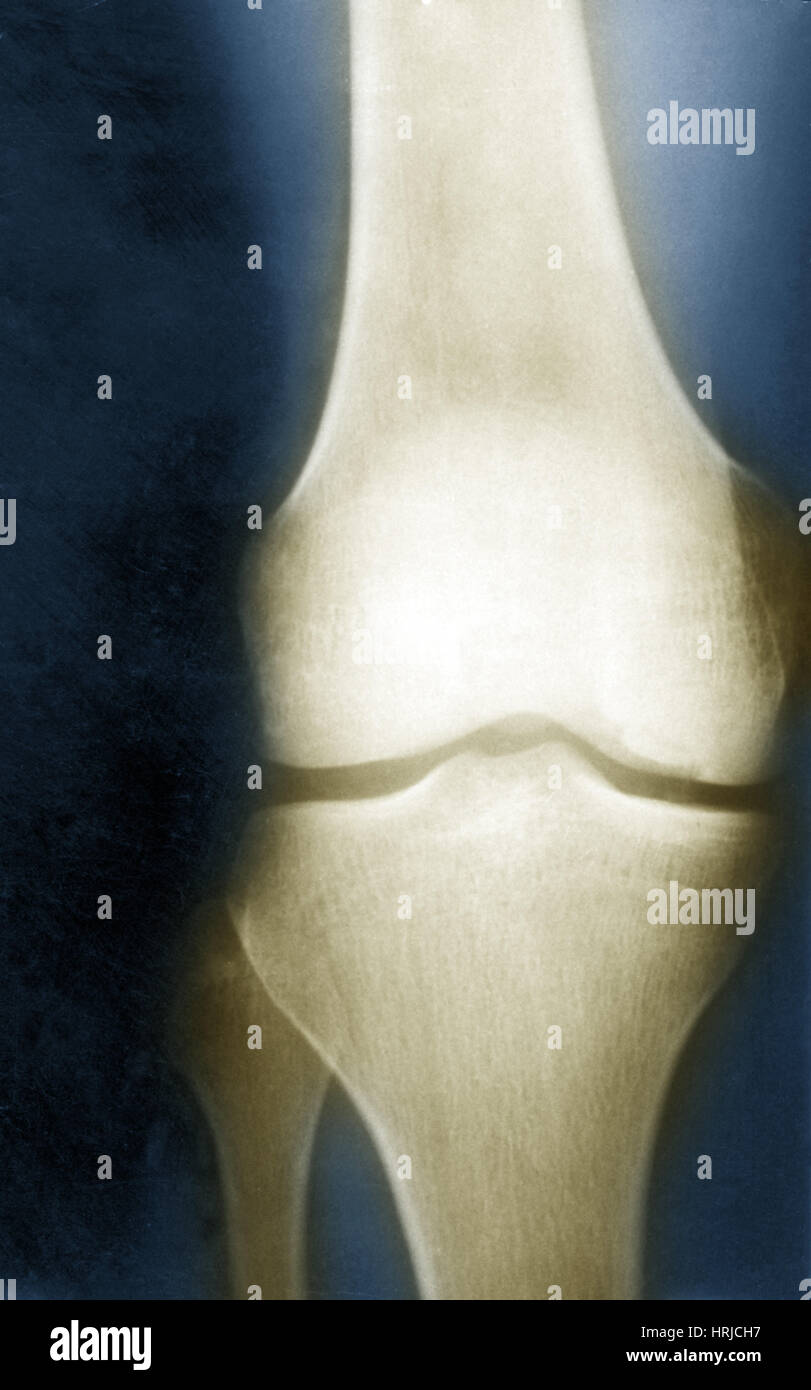 Normal knee x ray hi-res stock photography and images - Alamy