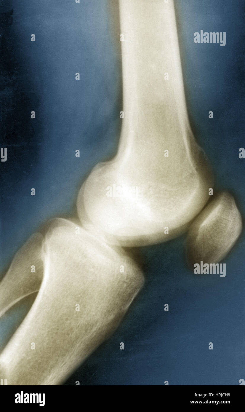 Normal knee x ray hi-res stock photography and images - Alamy