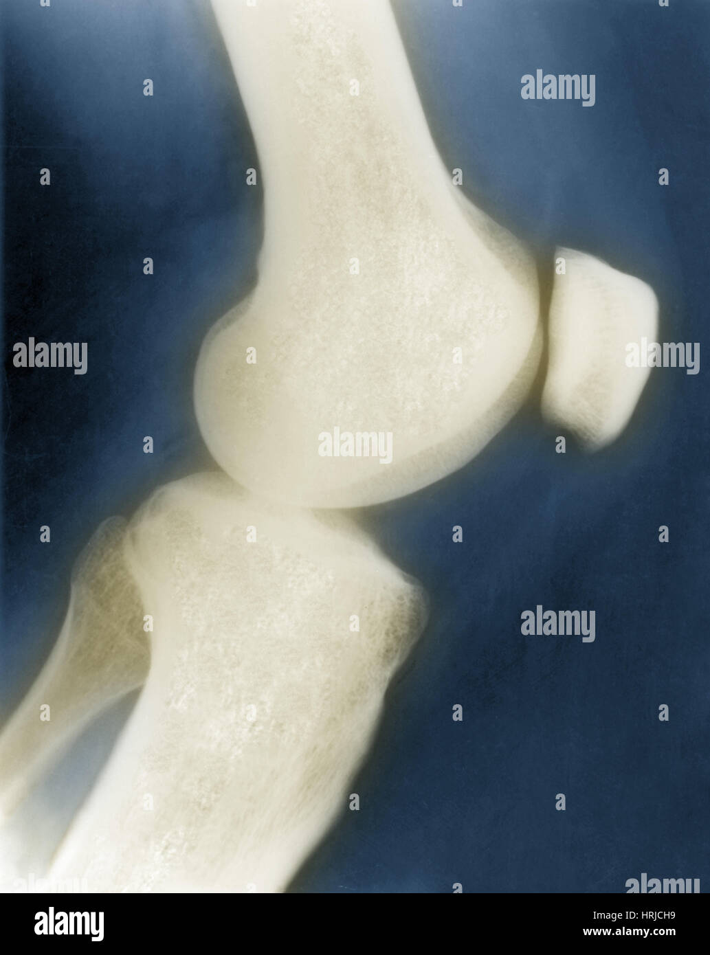 Knee Arthritis, X-ray Stock Photo - Alamy