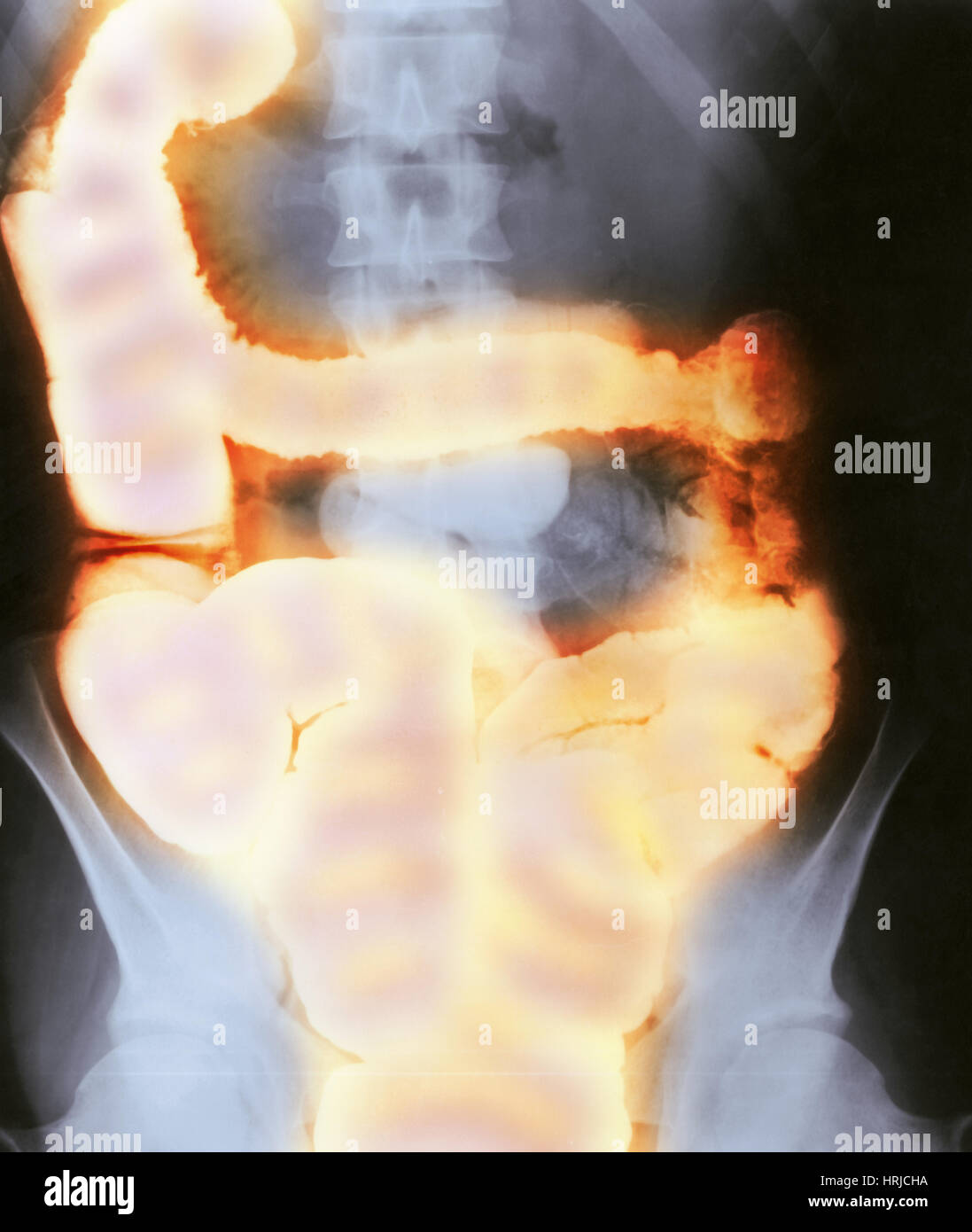 Spinal Cord, Ulcerative Colitis, X-ray Stock Photo - Alamy