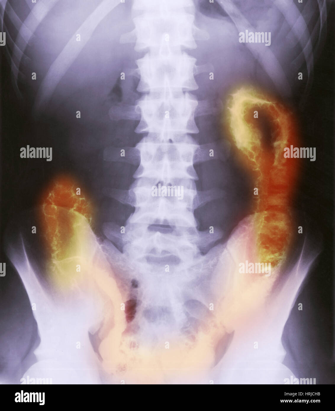 Spinal Cord, Ulcerative Colitis, X-ray Stock Photo - Alamy