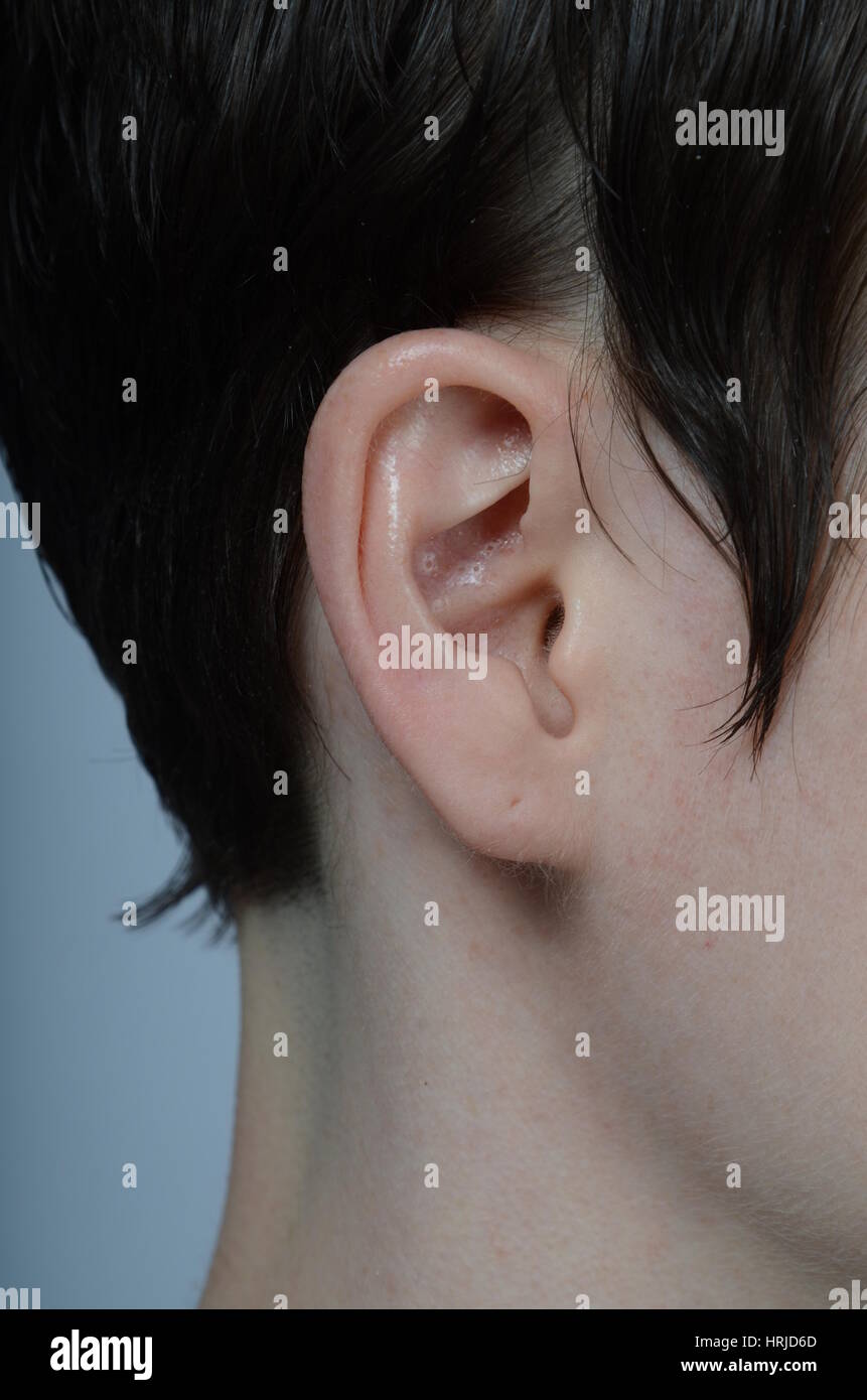 Cauliflower Ear From Piercing