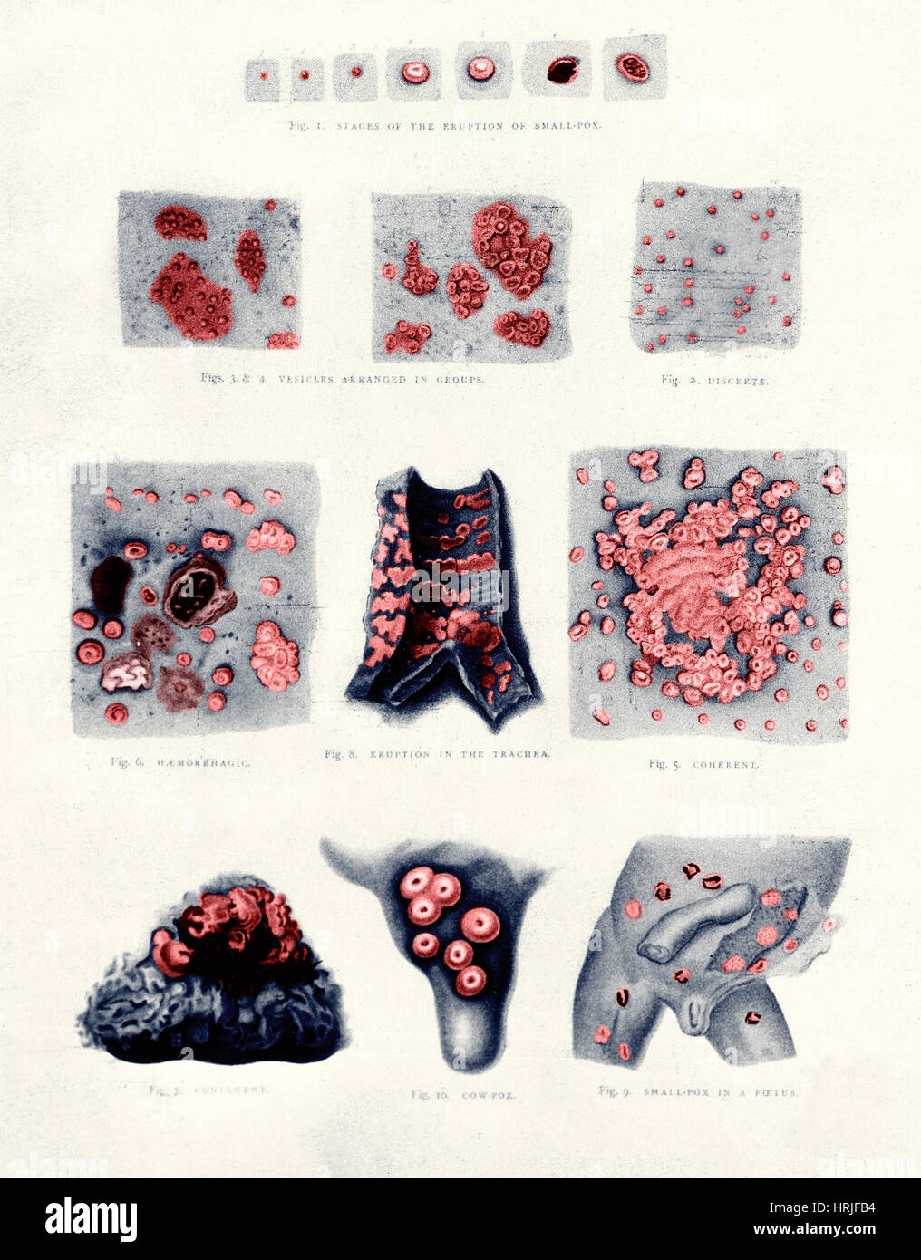 Stages and Types of Smallpox Stock Photo - Alamy