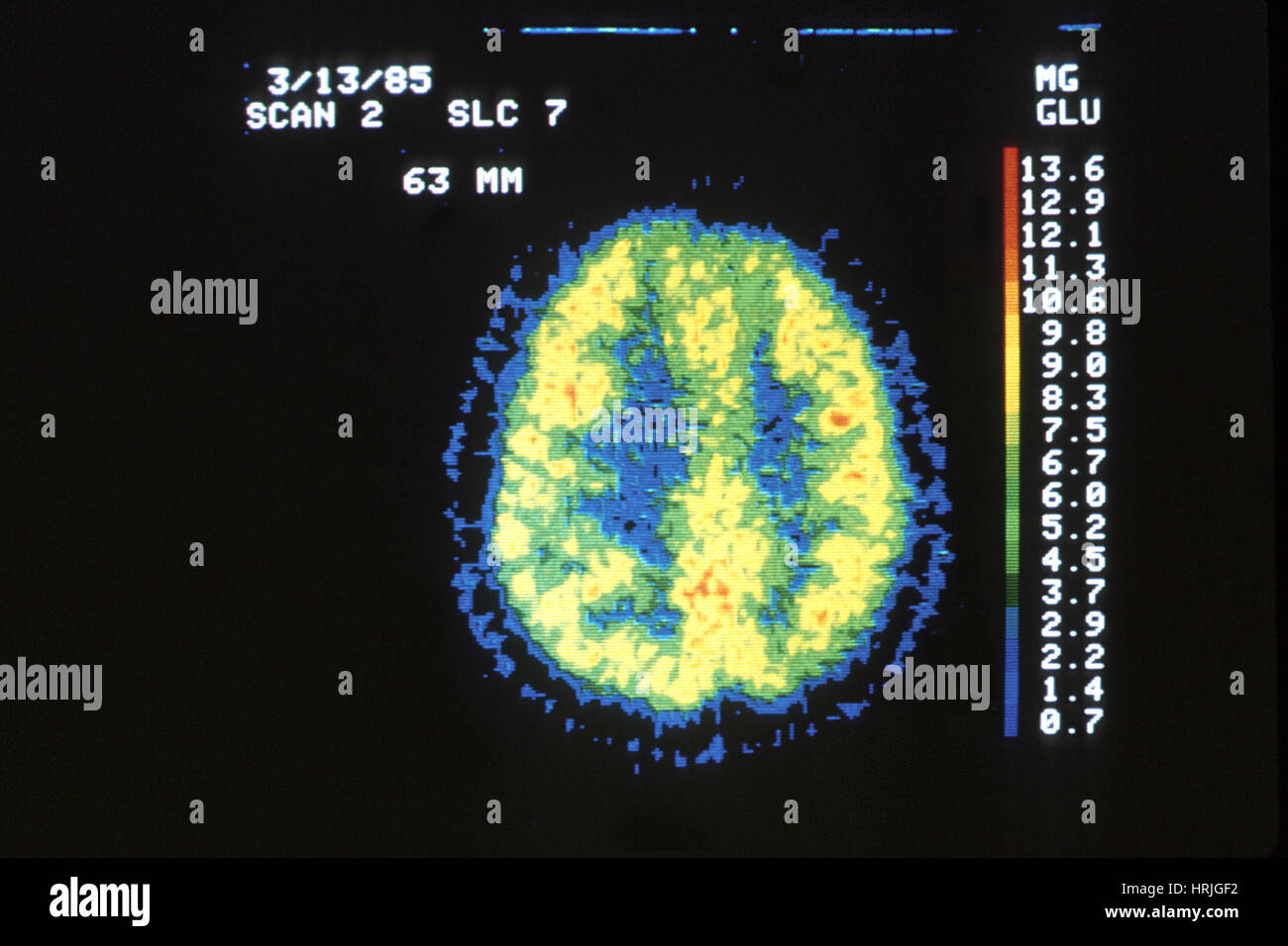 Normal Brain Scan Stock Photos & Normal Brain Scan Stock Images - Alamy
