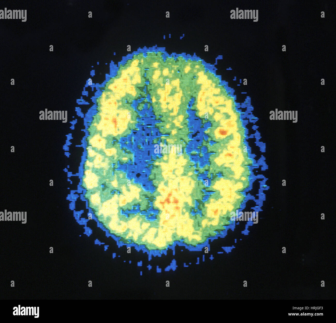 Pet Scan Brain High Resolution Stock Photography and Images - Alamy
