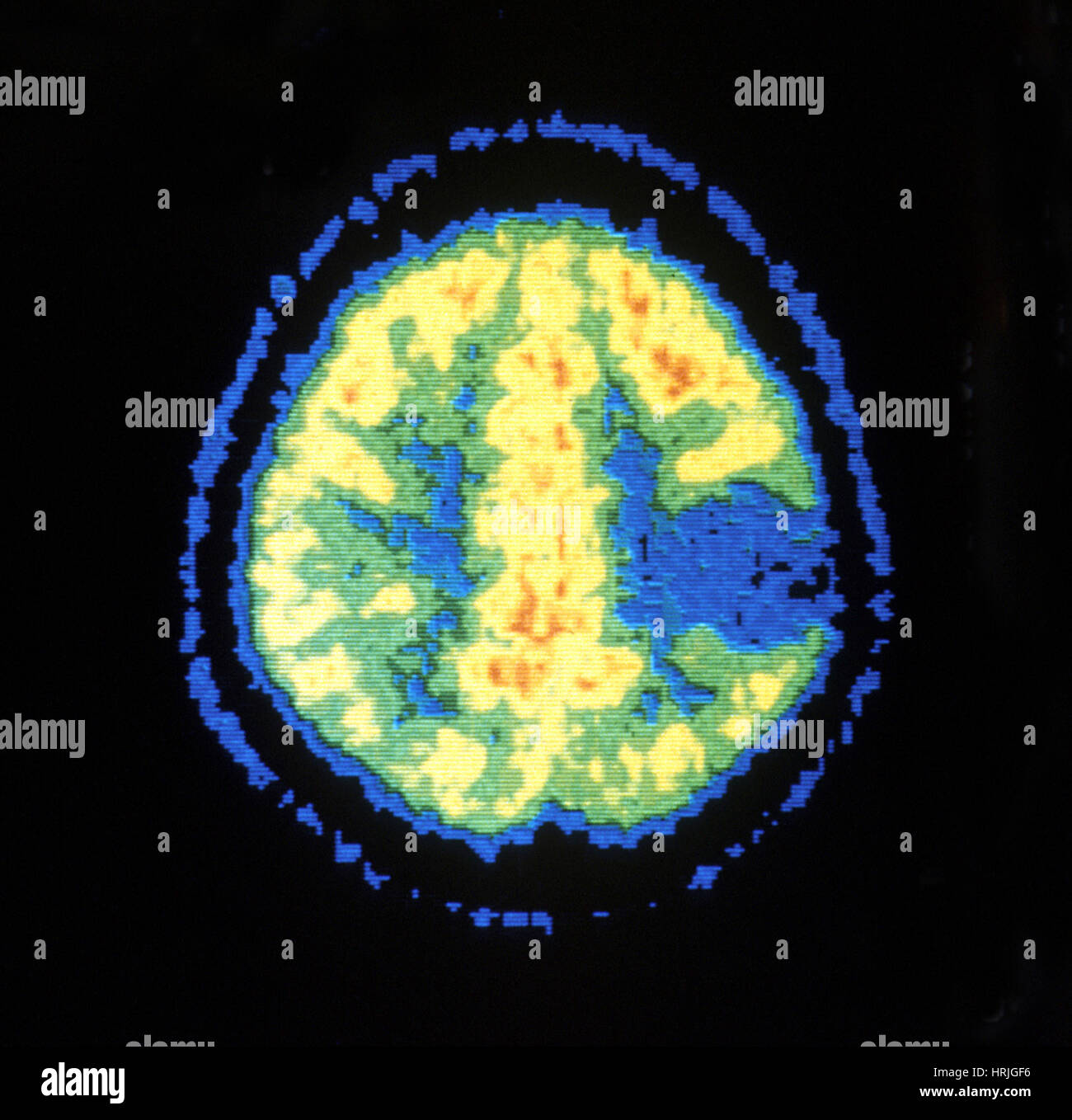 Epilepsy Scan High Resolution Stock Photography and Images - Alamy