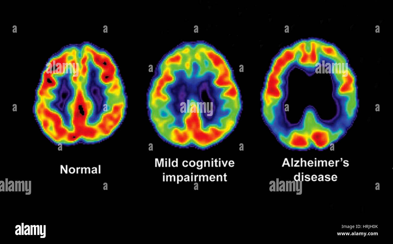 Normal, Impaired and Alzheimer Brain PET Scans Stock Photo - Alamy Normal, Impaired and Alzheimer Brain PET Scans Stock Photo - Alamy