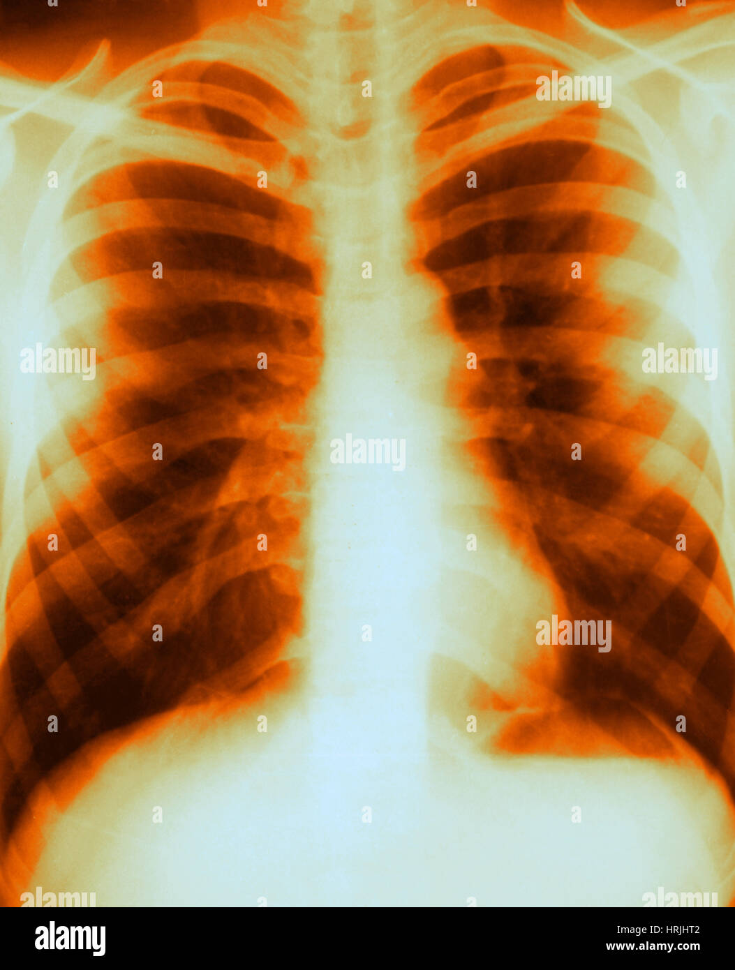 Chest Xray Ribs Lungs High Resolution Stock Photography and Images - Alamy