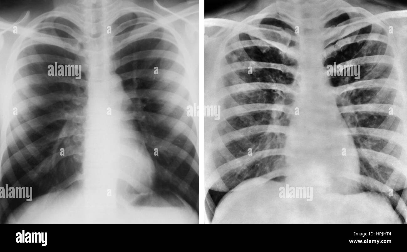Normal lungs Black and White Stock Photos & Images - Alamy