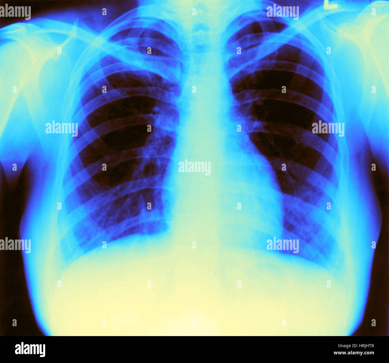 X-ray of Heart and Lungs Stock Photo - Alamy