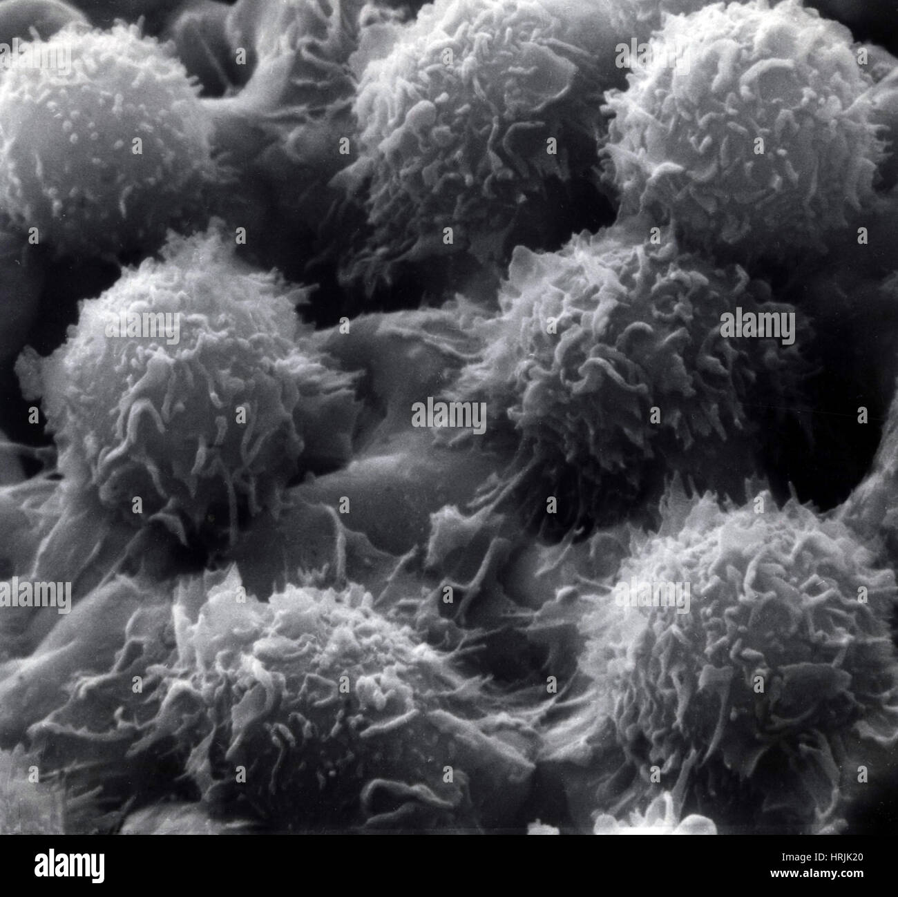 Hairy cell leukemia hi-res stock photography and images - Alamy