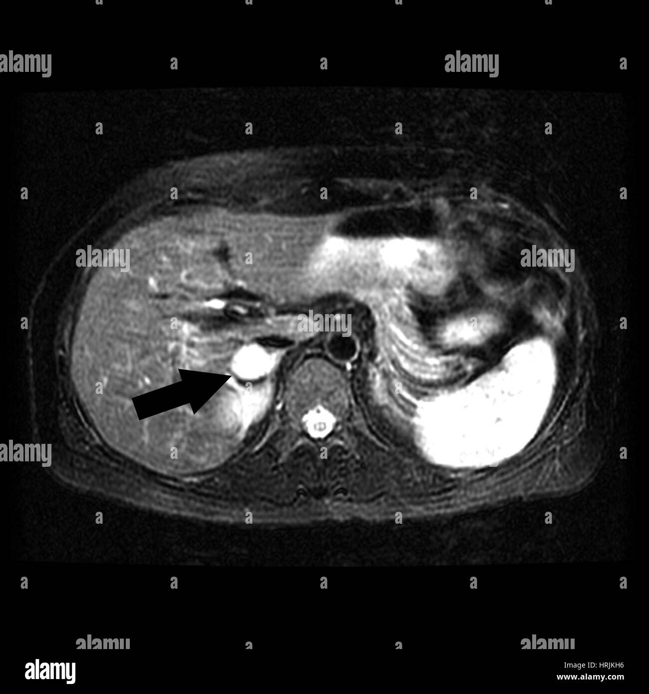 Adrenal Pheochromocytoma, MRI Stock Photo - Alamy