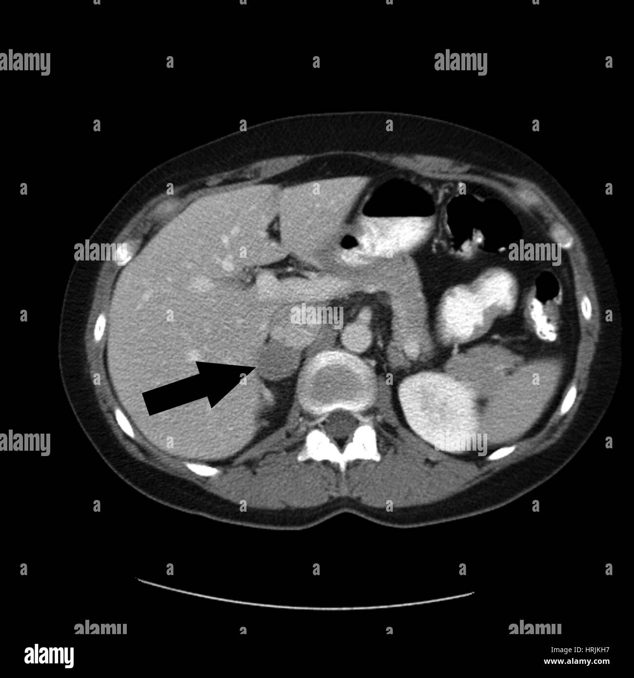 Adrenal Pheochromocytoma, CT Stock Photo - Alamy