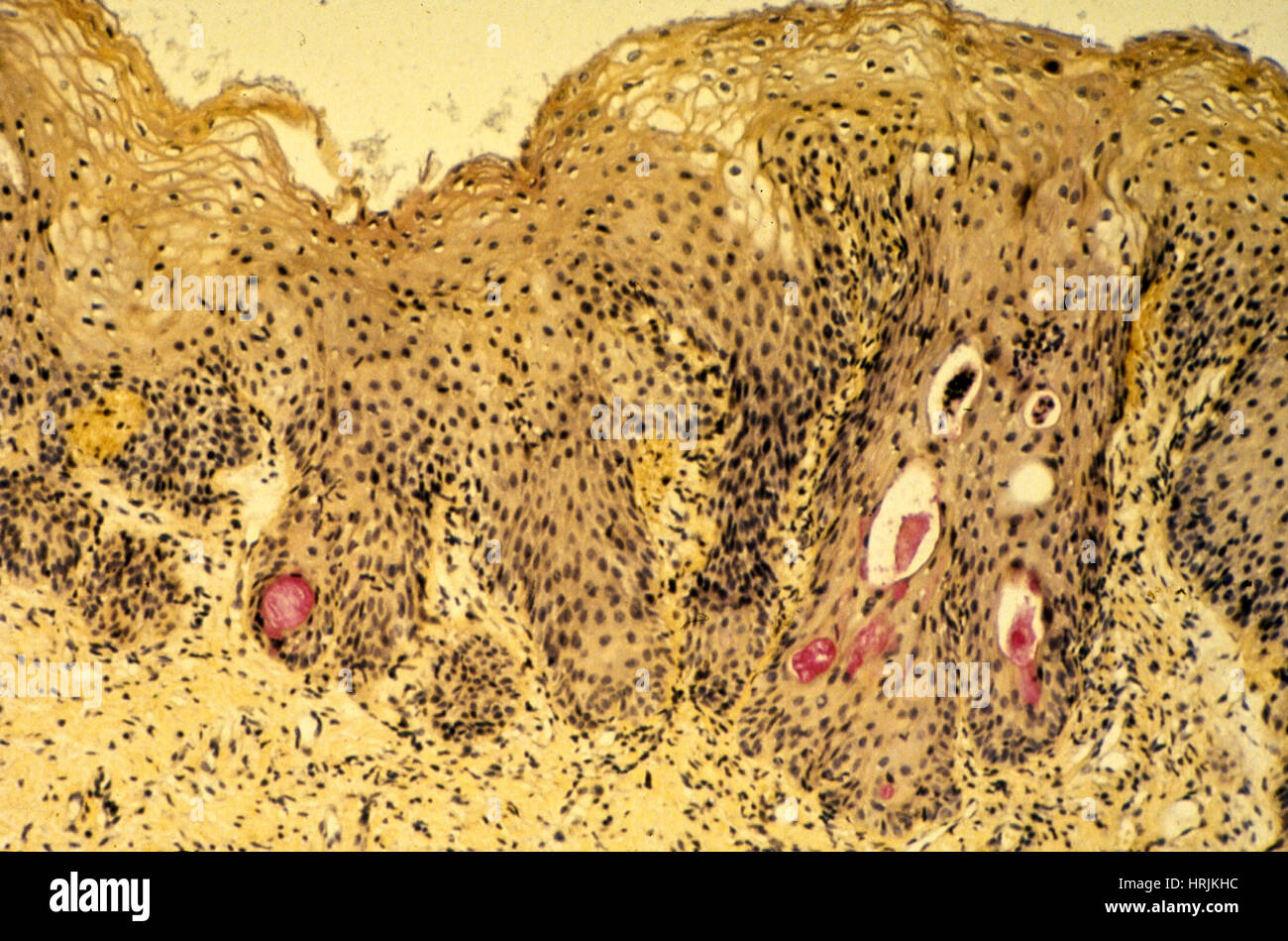 Cervical Cancer, Intrauterine DES Exposure, LM Stock Photo - Alamy