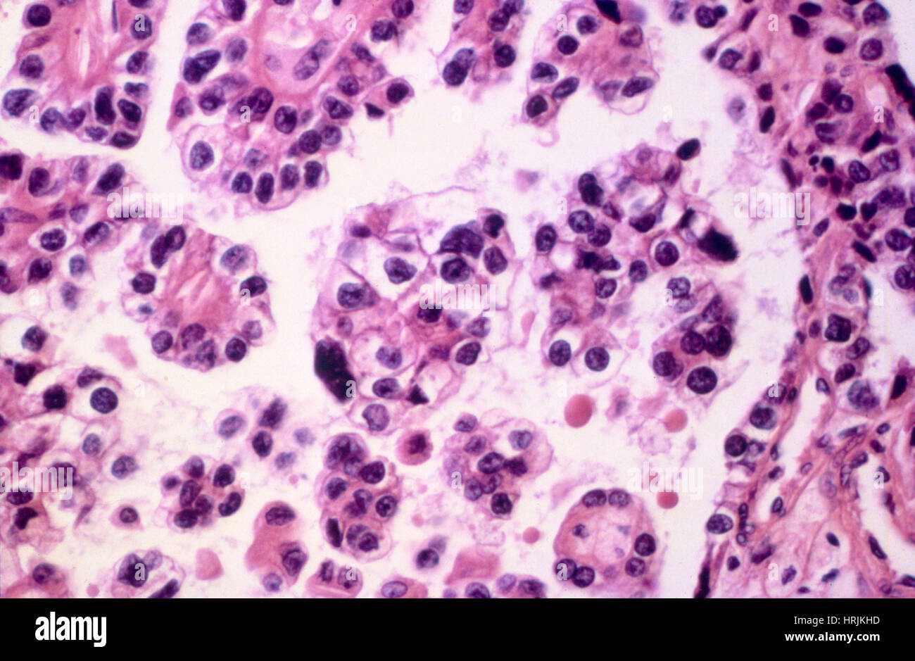 Cervical Cancer, Intrauterine DES Exposure, LM Stock Photo - Alamy