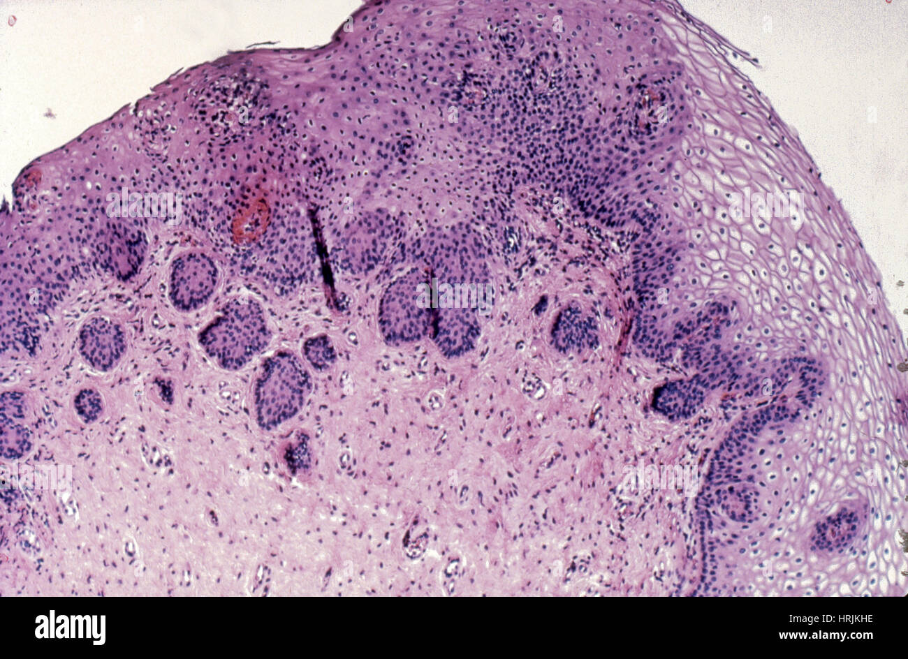 Cervical Cancer, Intrauterine DES Exposure, LM Stock Photo - Alamy