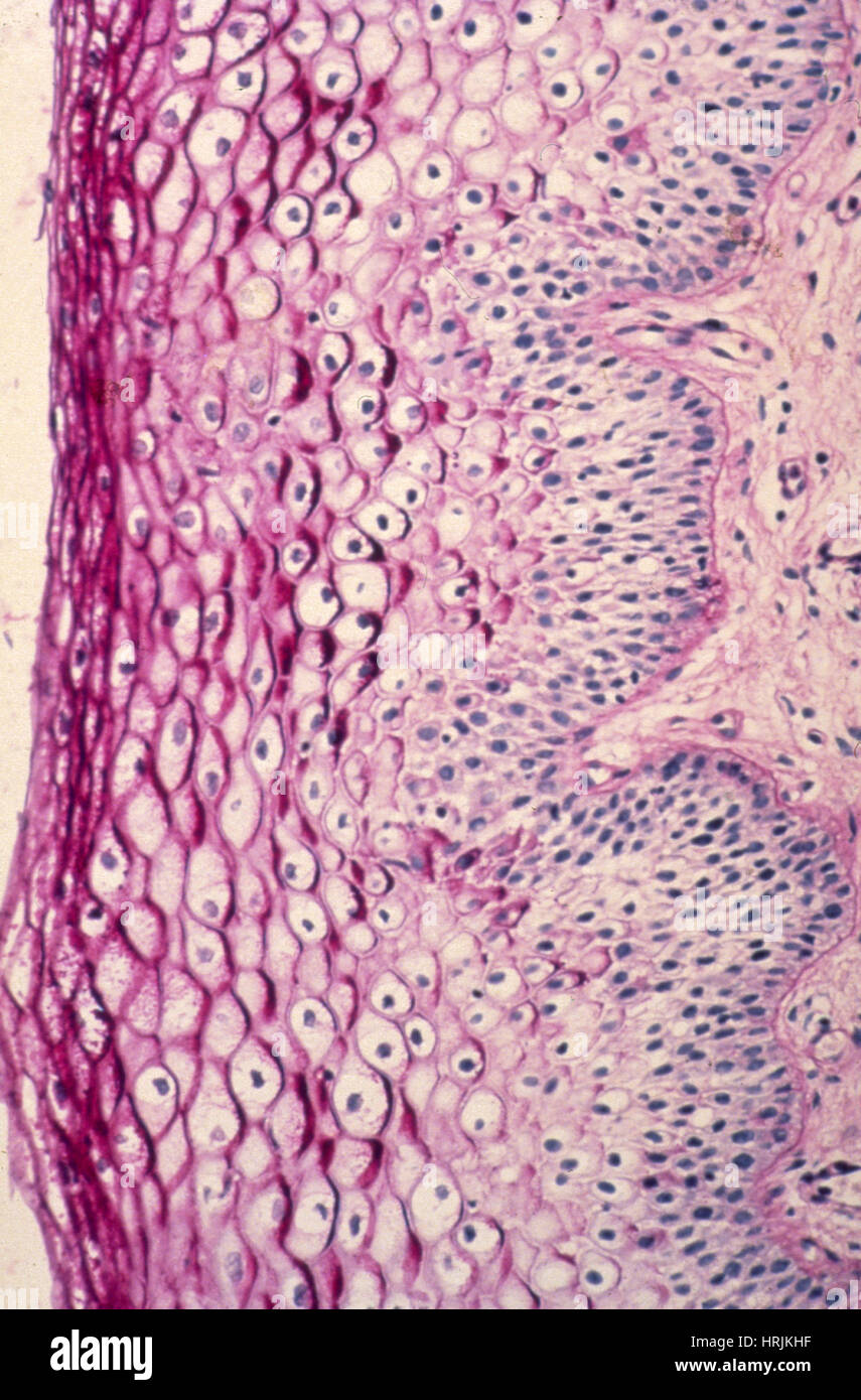 Cervical Cancer, Intrauterine DES Exposure, LM Stock Photo - Alamy