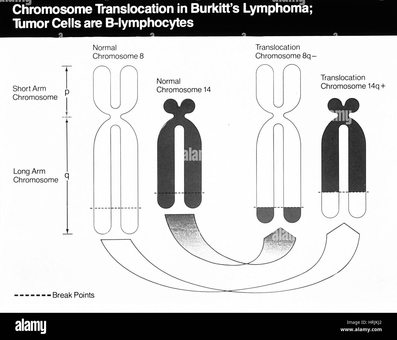 Burkitt translocation hi-res stock photography and images - Alamy