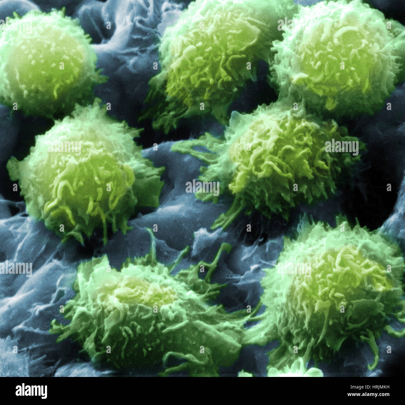 Hairy cell leukemia High Resolution Stock Photography and Images - Alamy