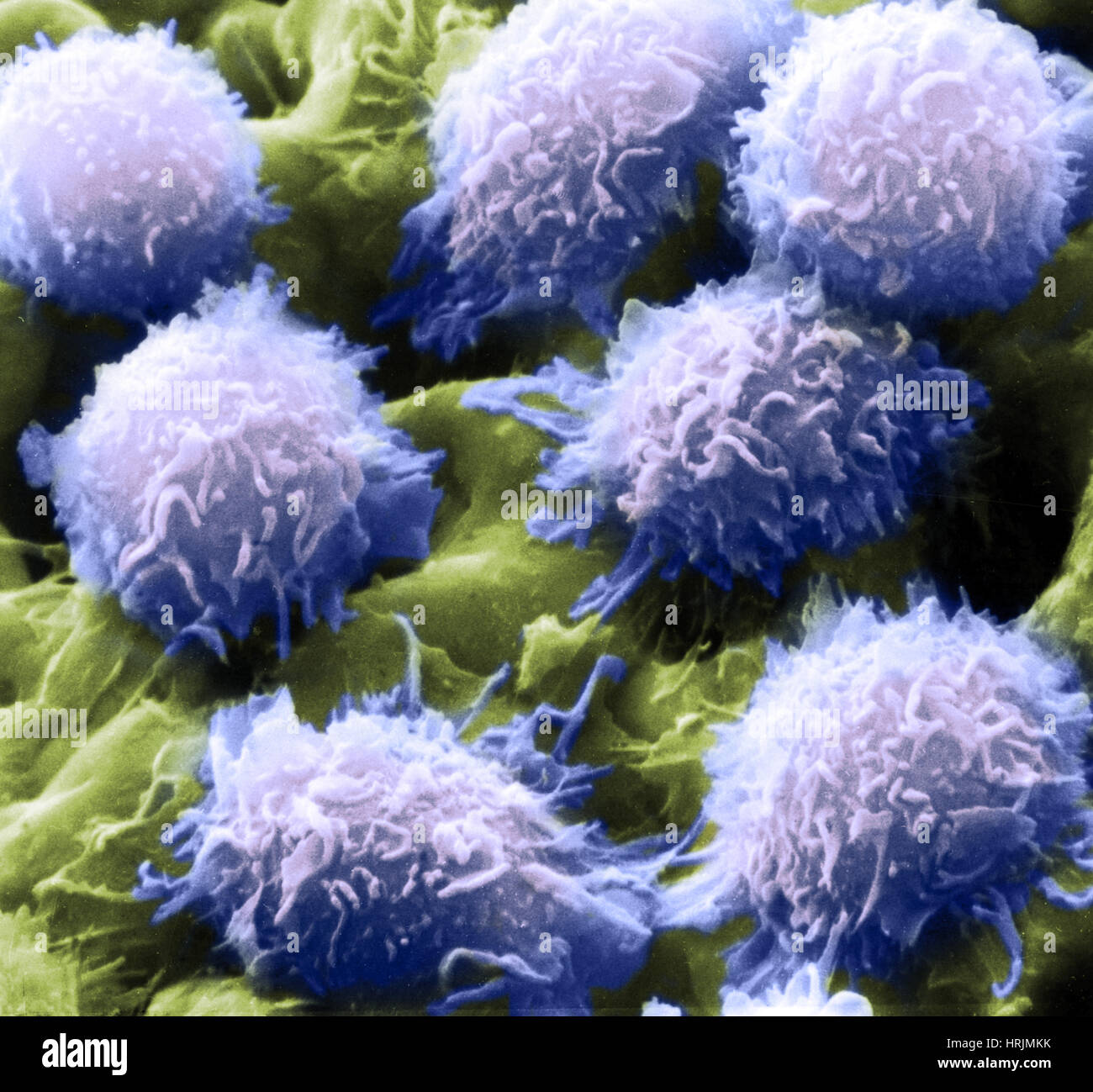 Hairy cell leukemia hi-res stock photography and images - Alamy