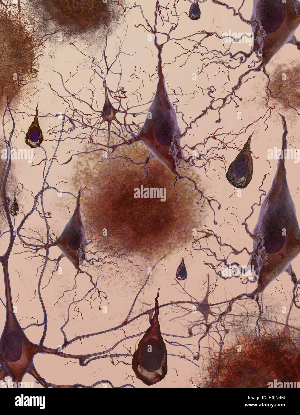 Alzheimer's Disease, Neuro-Degeneration Stock Photo - Alamy