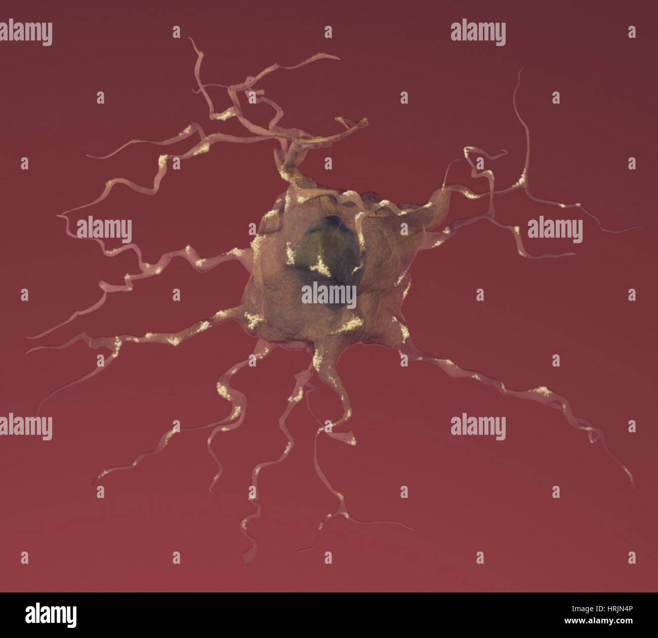 Alzheimer's Disease, Dying Neuron Stock Photo - Alamy