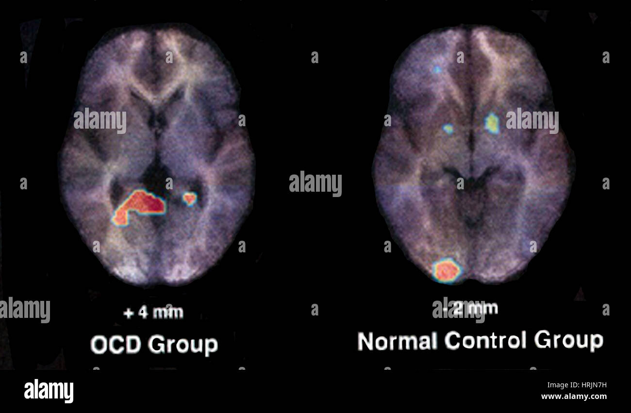 PET Scan, Normal and OCD Brain Stock Photo - Alamy PET Scan, Normal and OCD Brain Stock Photo - Alamy
