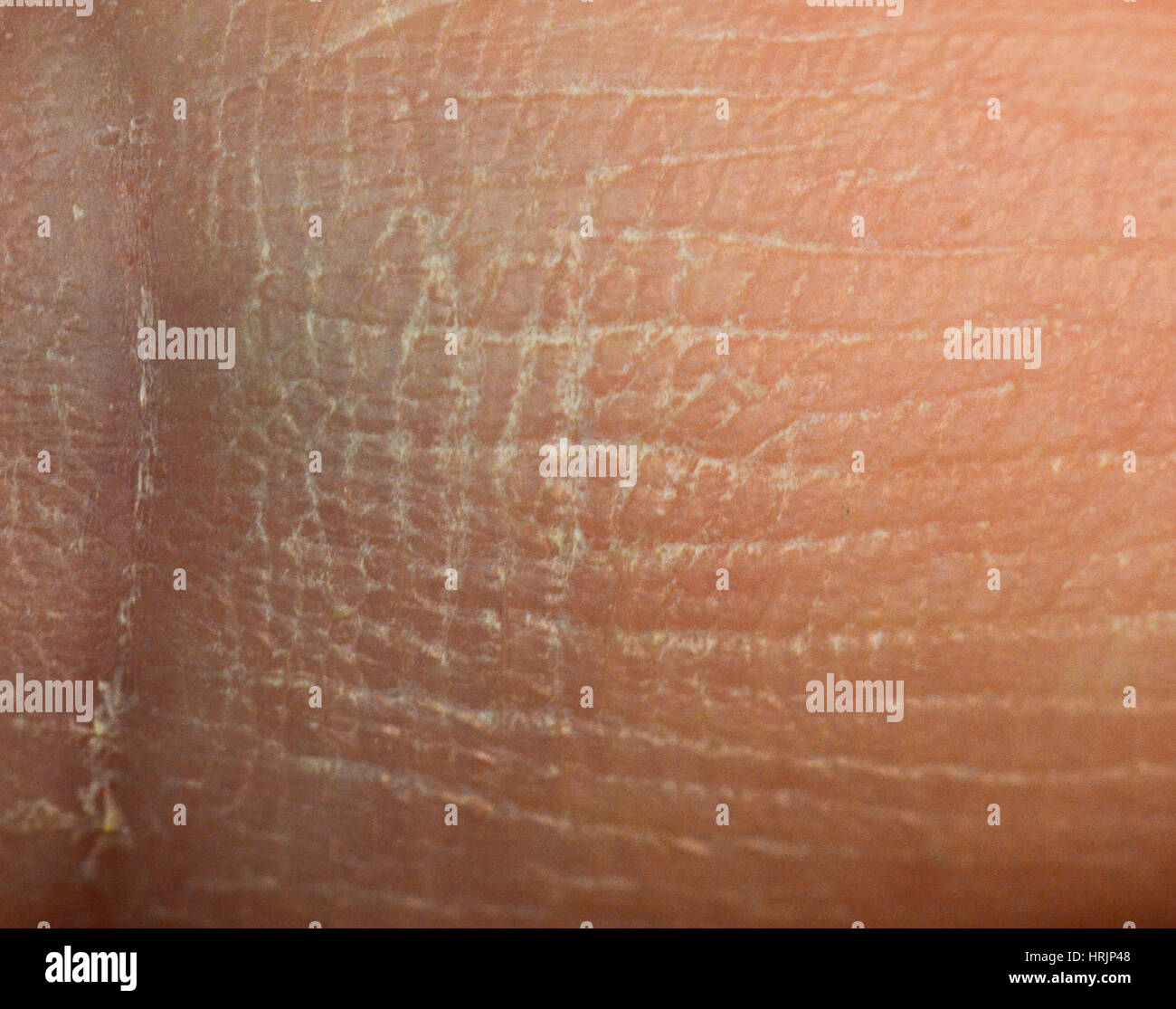 Dry Skin, Close-Up Stock Photo - Alamy