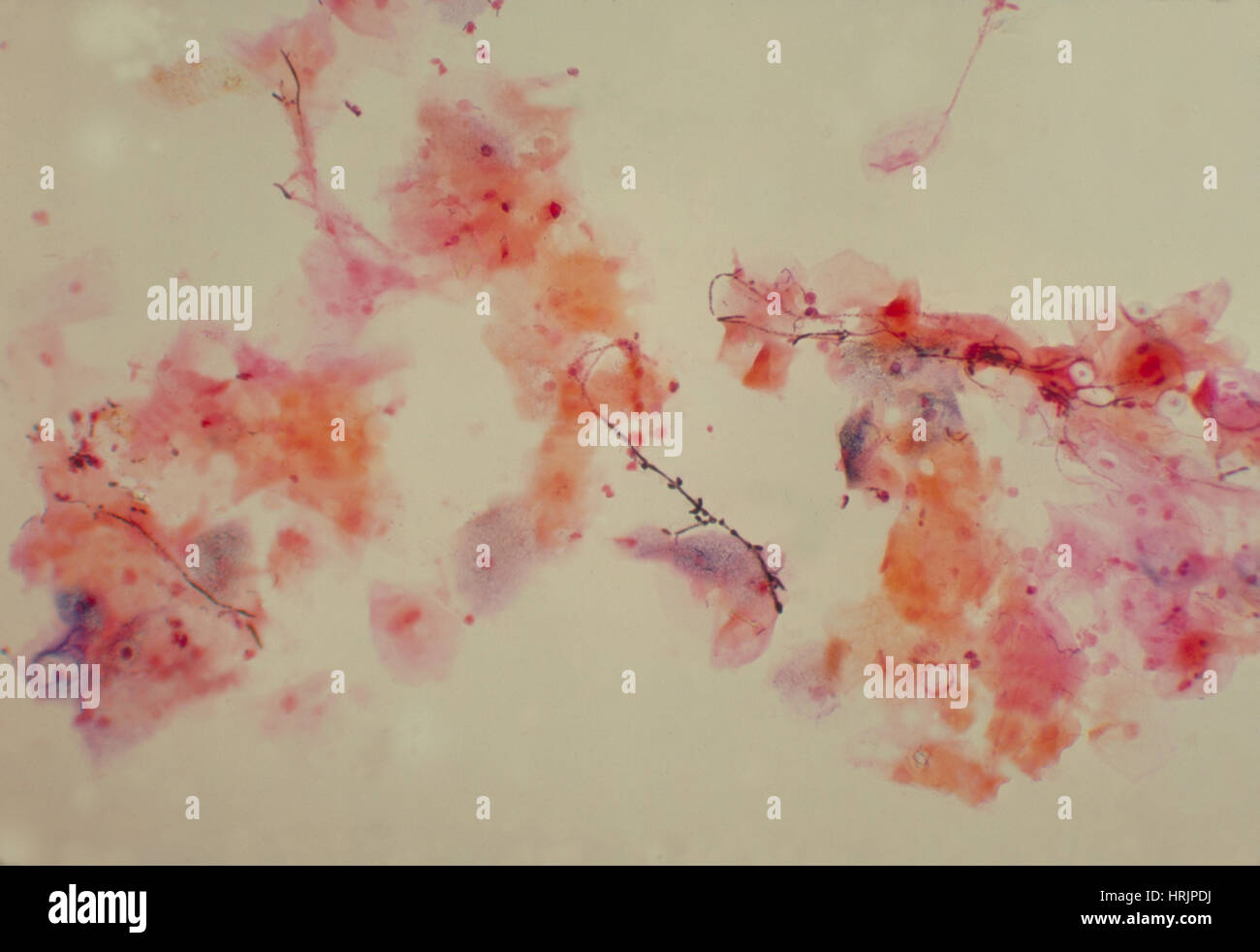 Candida albicans, Vaginal Smear, LM Stock Photo - Alamy