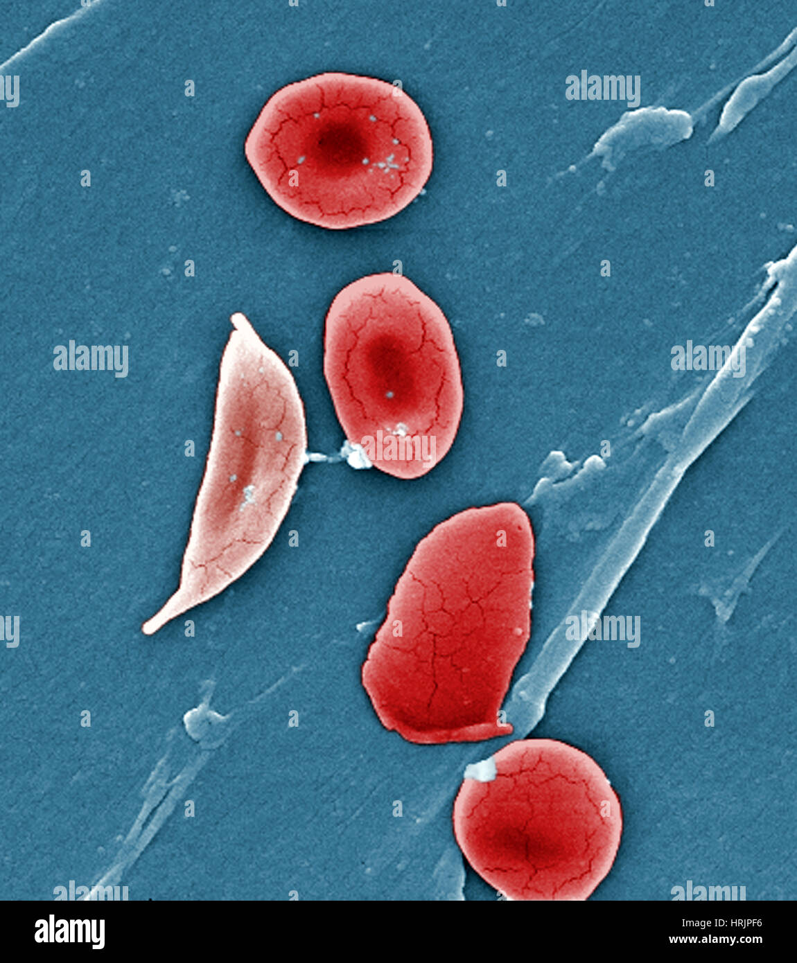 Sickle cell anemia microscopy hi-res stock photography and images - Alamy