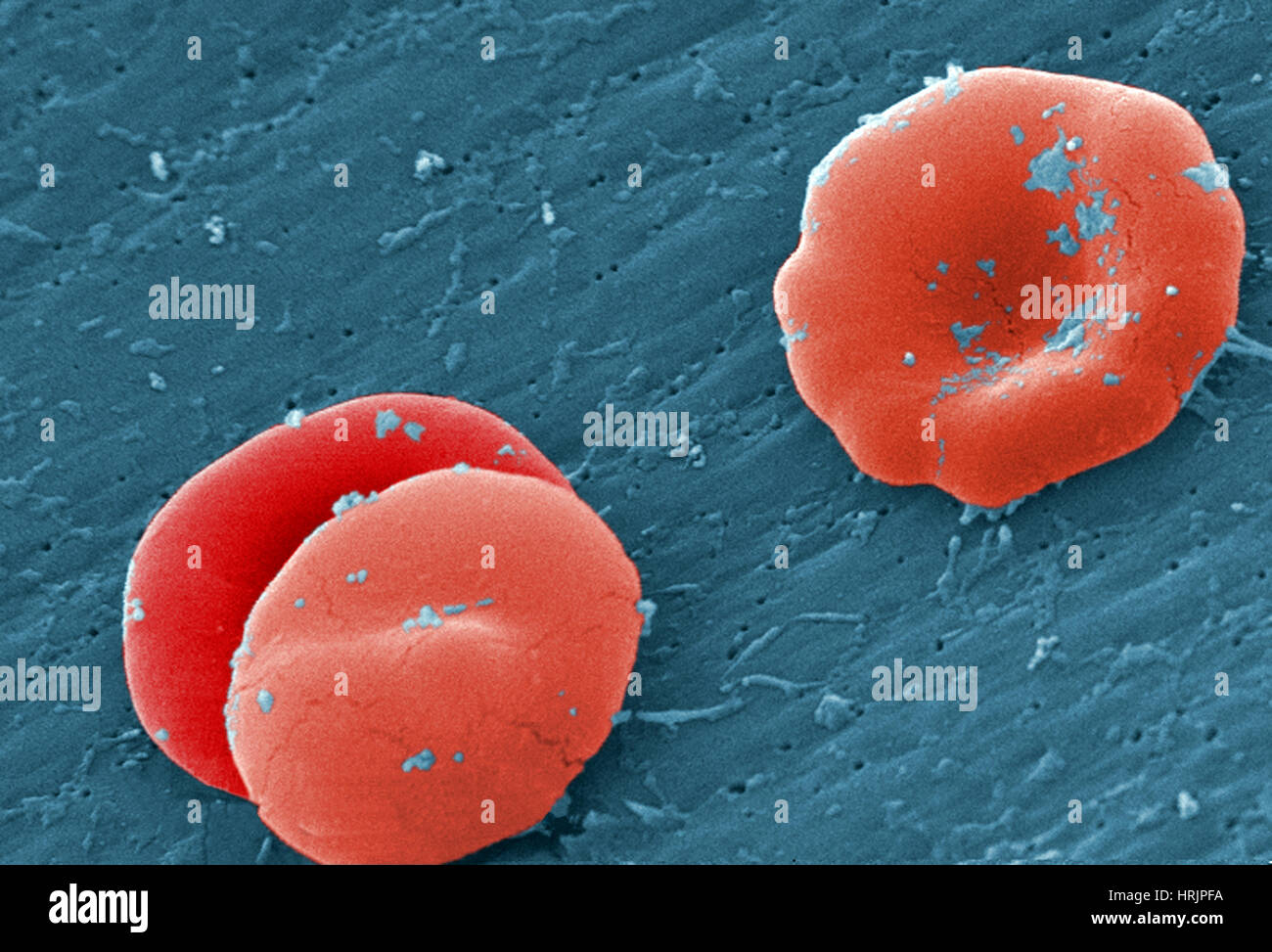 Sickle cell anemia microscopy hi-res stock photography and images - Alamy