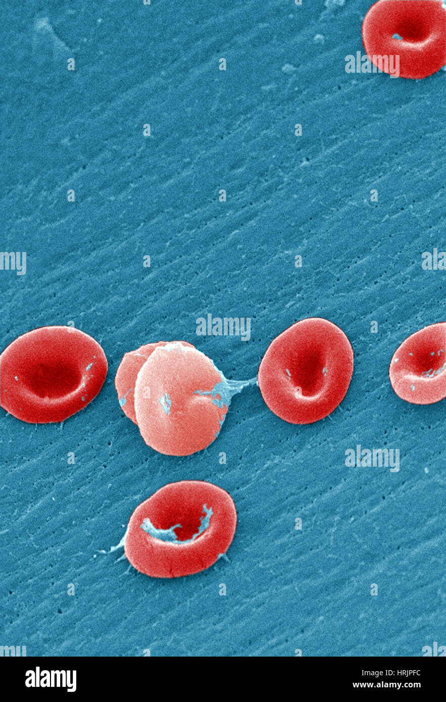 Sickle cell anemia microscopy hi-res stock photography and images - Alamy