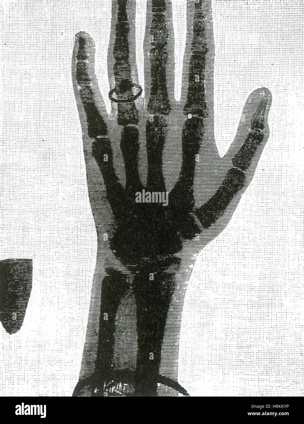 Xray hand child hi-res stock photography and images - Alamy