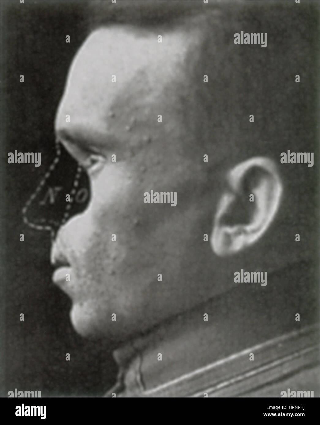 Reconstruction surgery wwi hi-res stock photography and images - Alamy