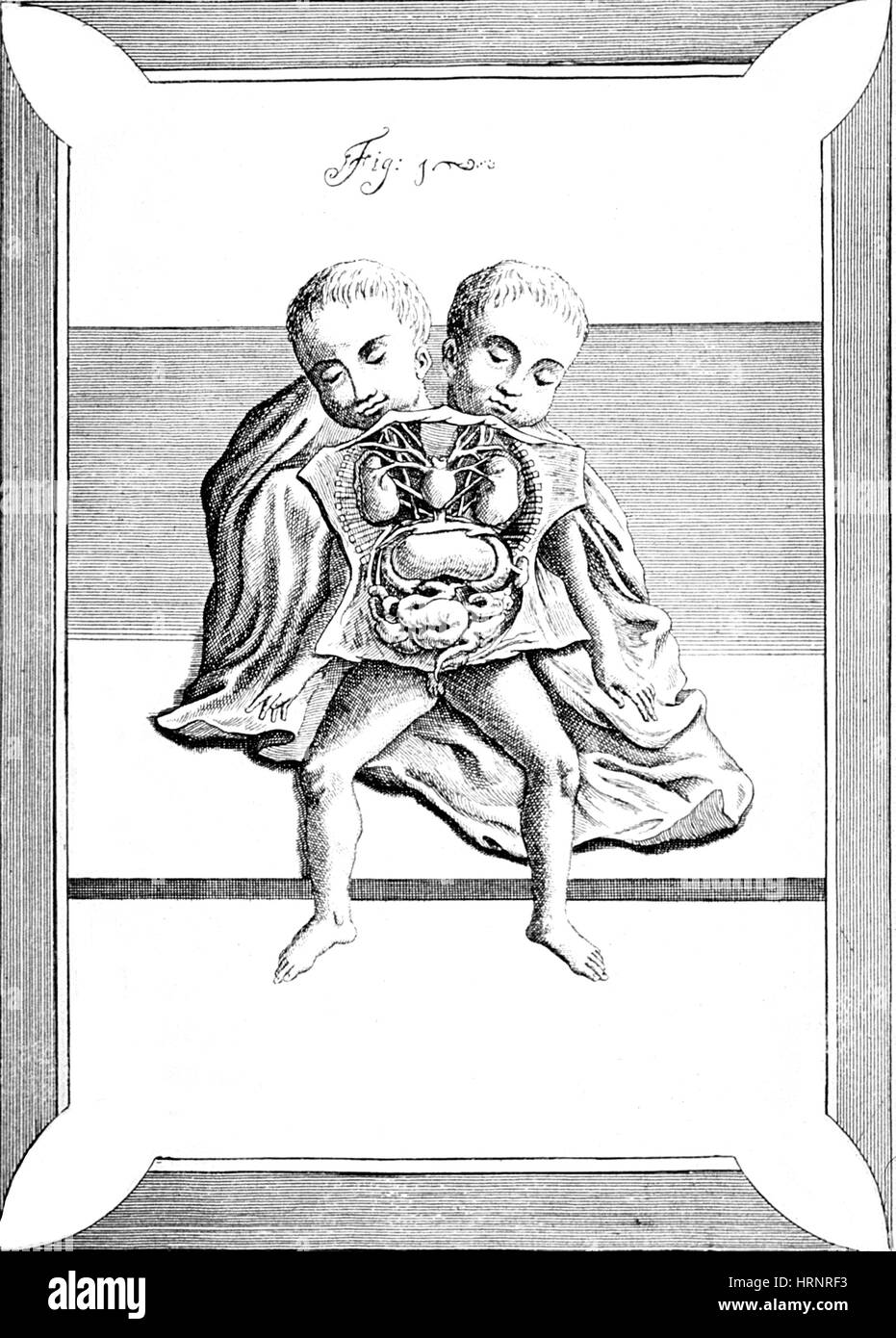 Conjoined twins 18th century hi-res stock photography and images - Alamy