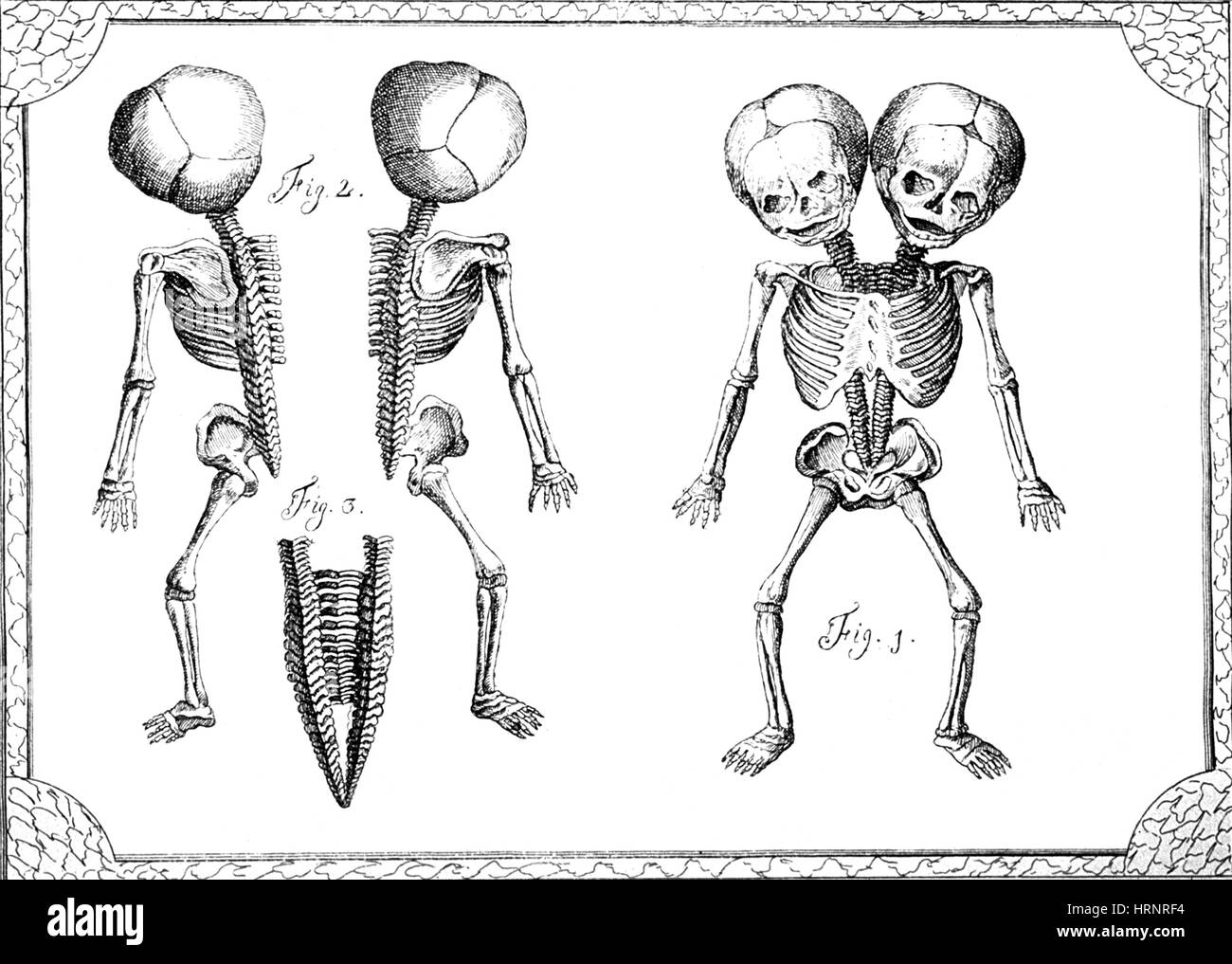 Conjoined twins 18th century hi-res stock photography and images - Alamy