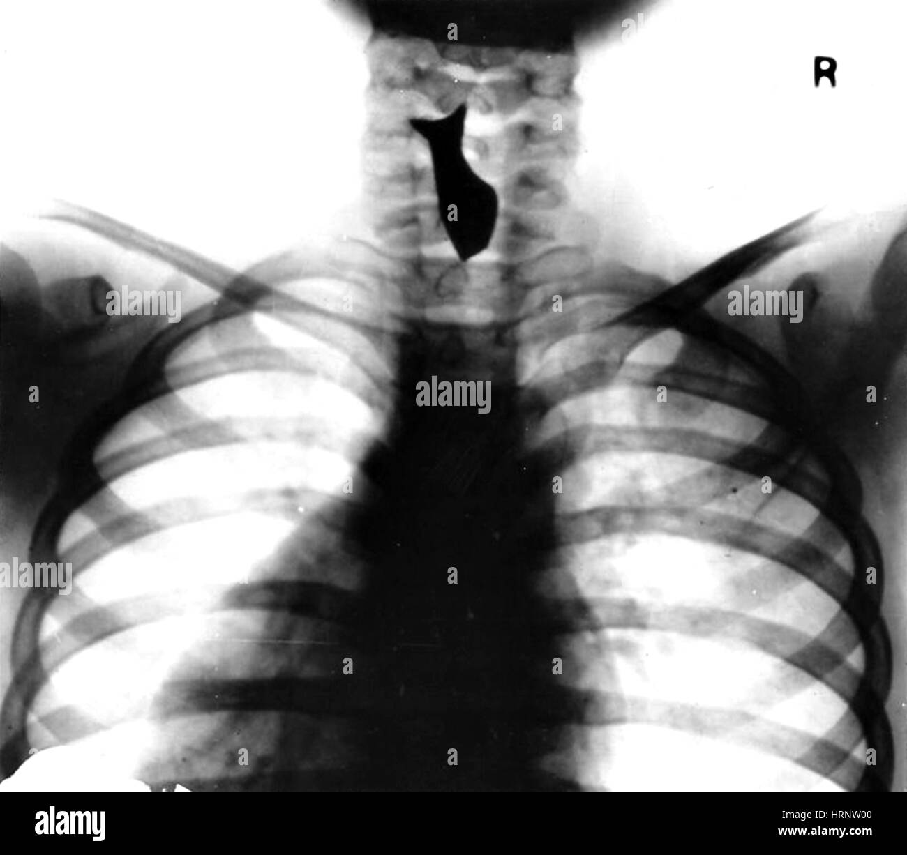 Swallowed x ray hi-res stock photography and images - Alamy