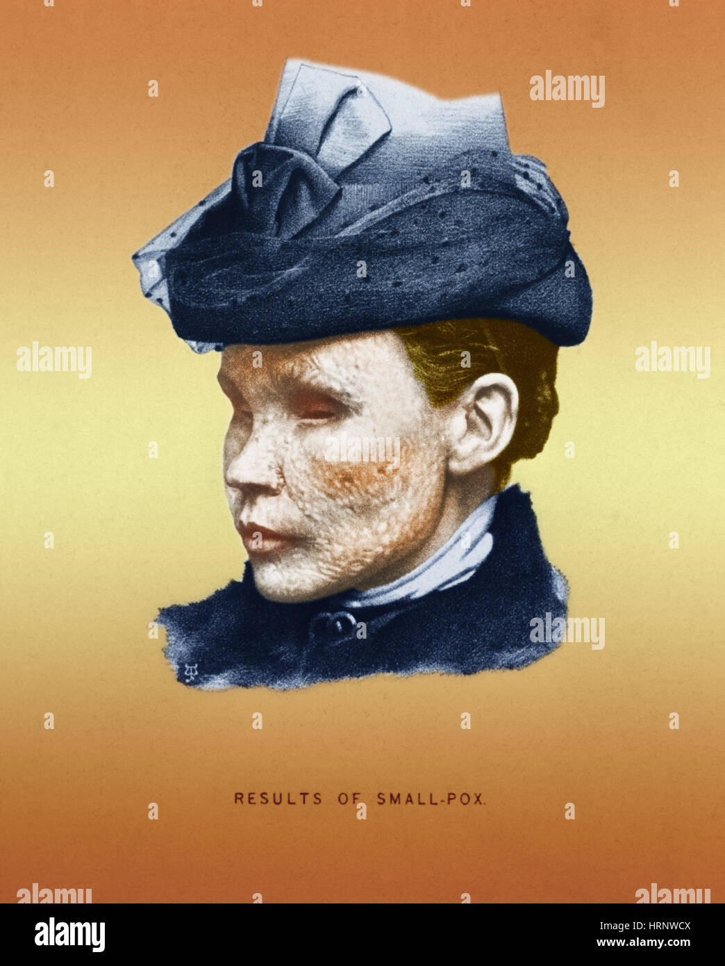 Woman with Smallpox Stock Photo - Alamy