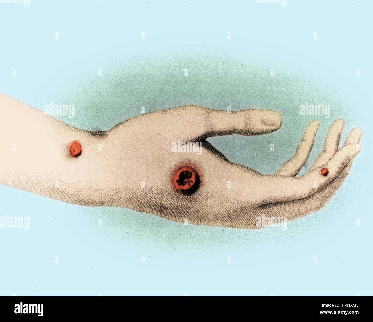 Smallpox victim hi-res stock photography and images - Alamy