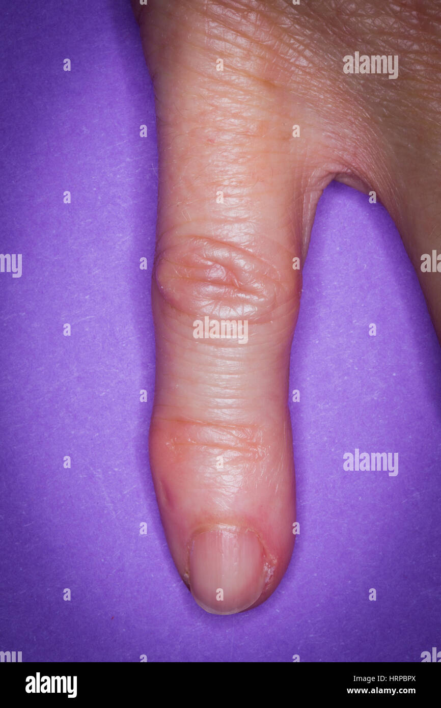 Deformed joint hi-res stock photography and images - Alamy