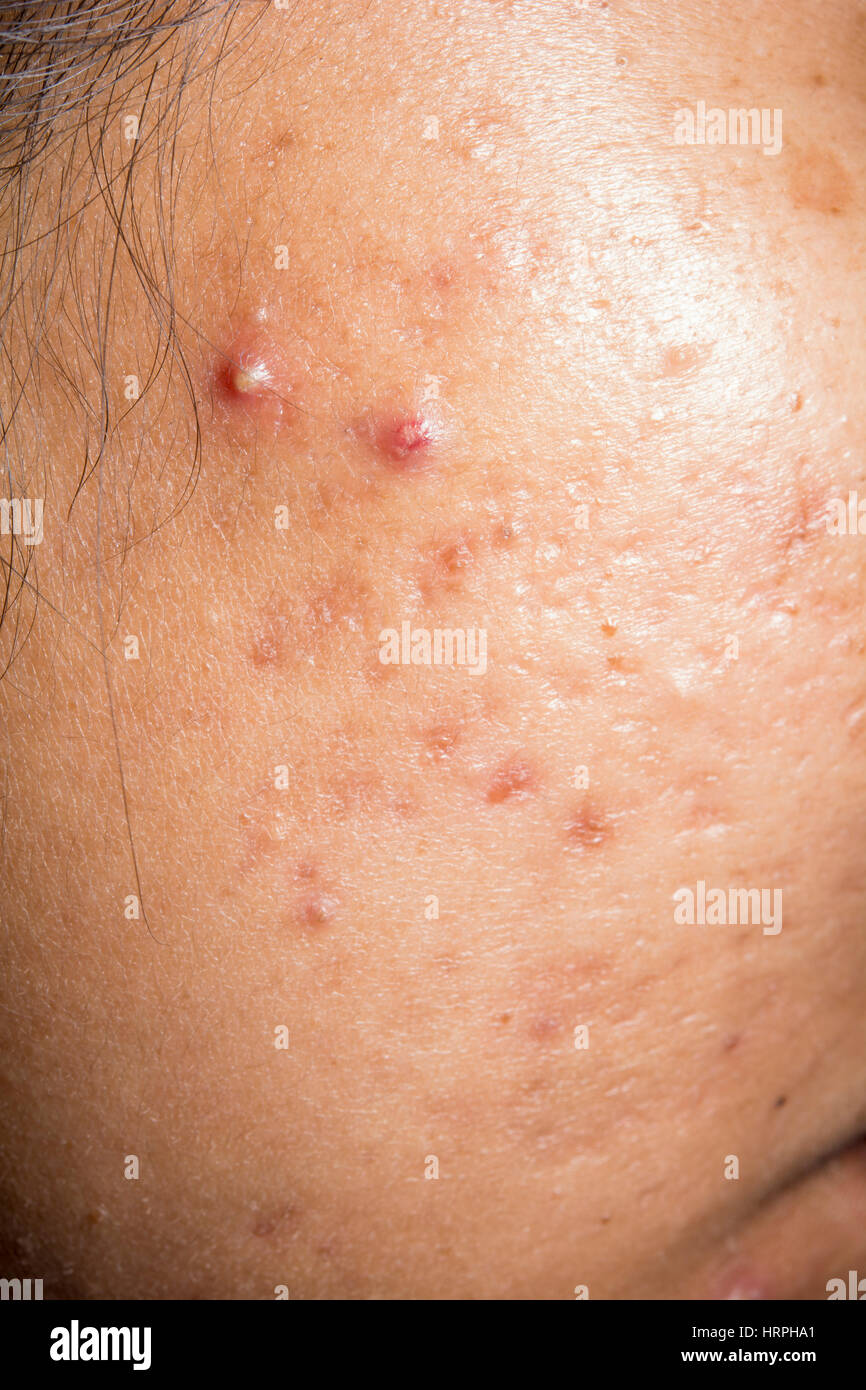 close up for acne on women face Stock Photo - Alamy