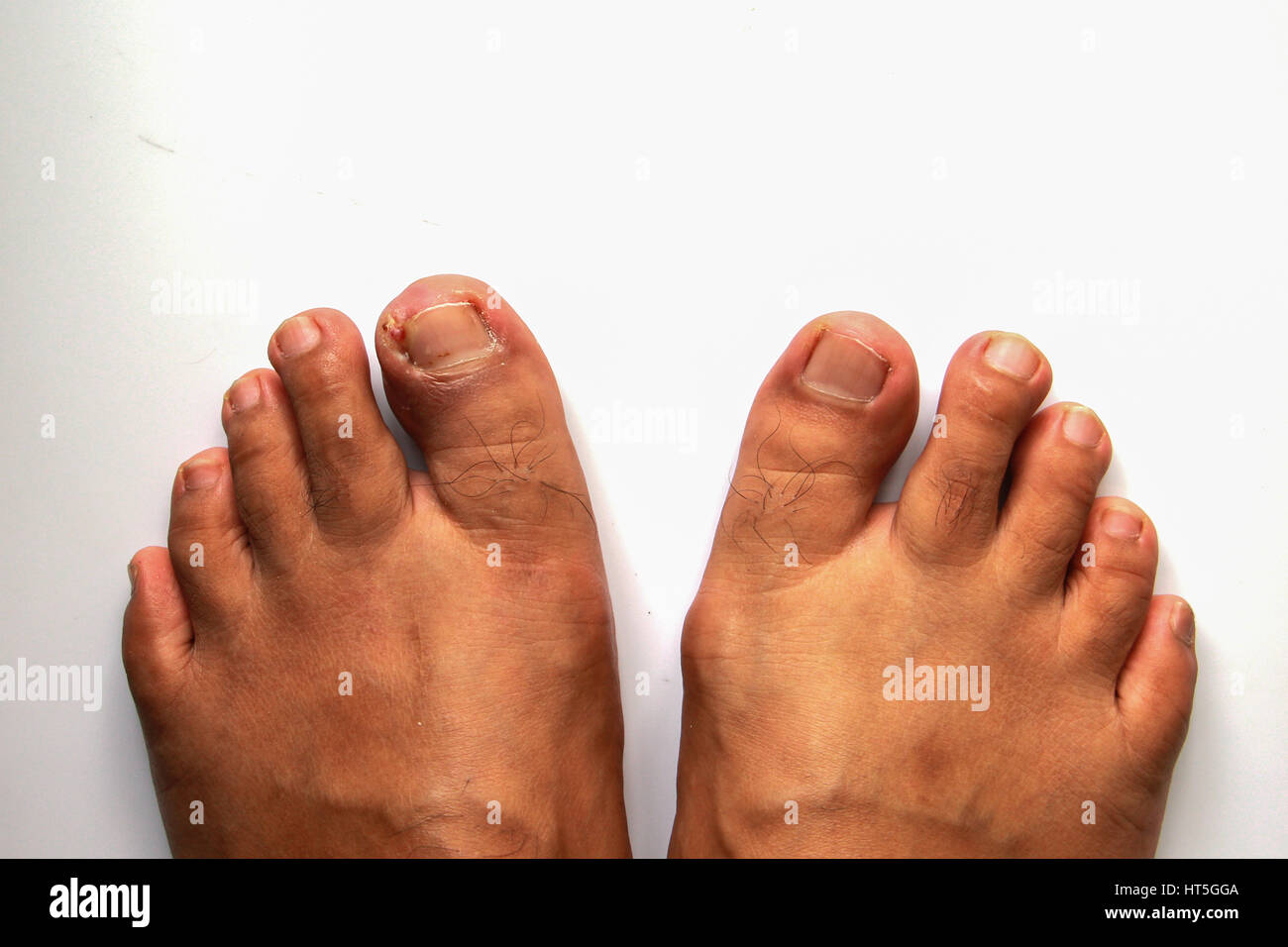 Cracked toe hi-res stock photography and images - Alamy