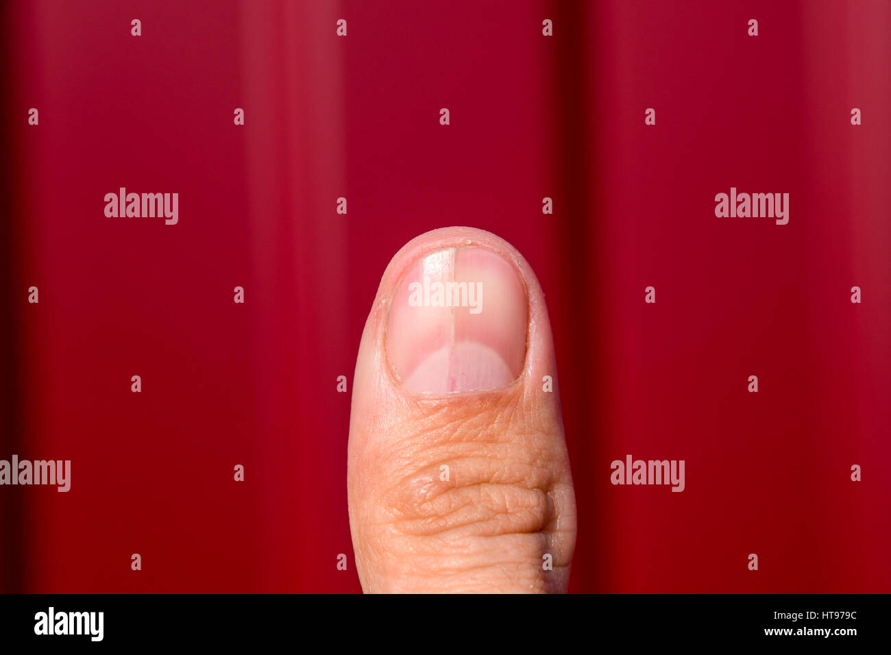 Forked nail on the thumb. Dilation of the nail, traumatic pathology ...