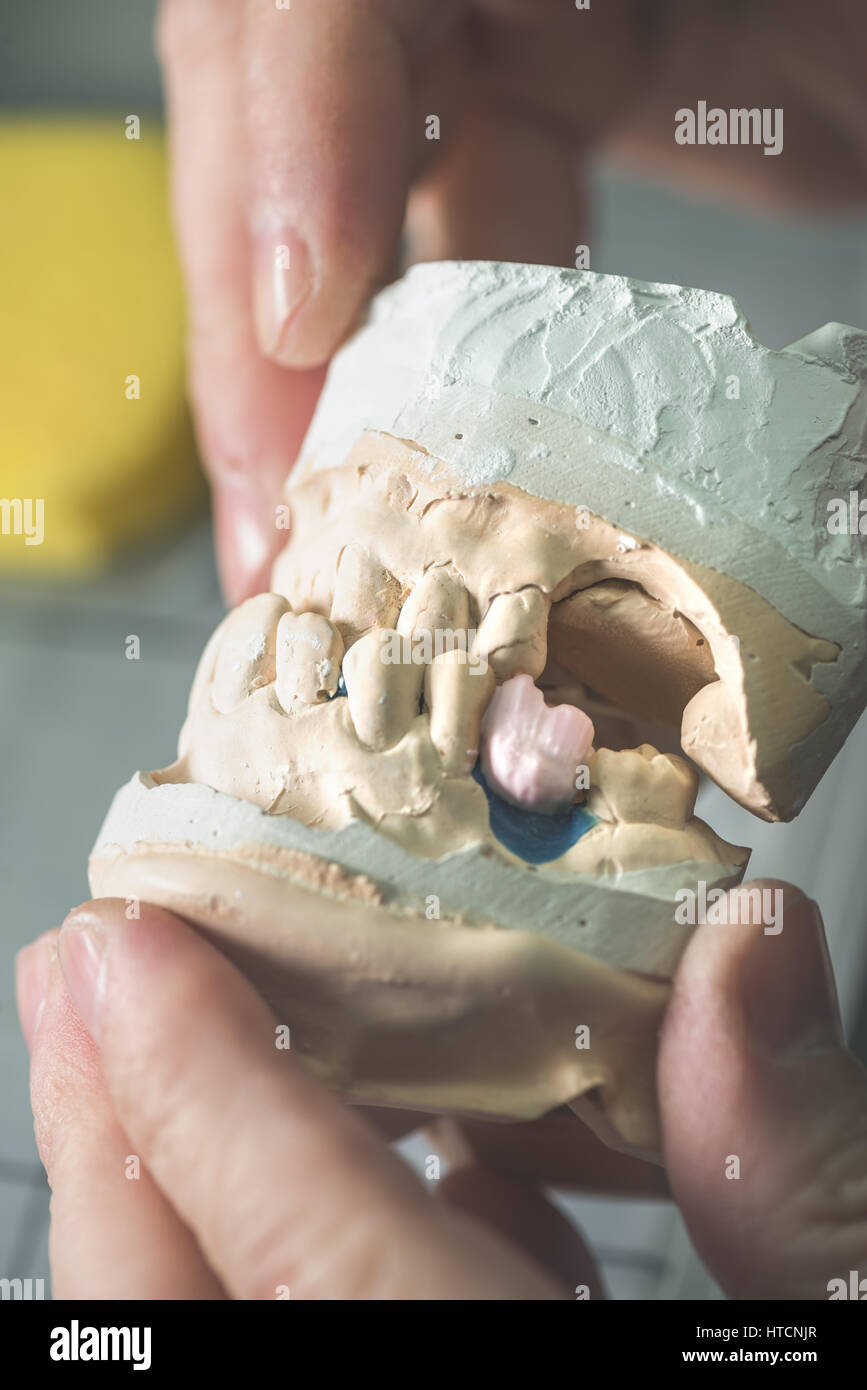 Dental prosthesis, artificial tooth, prosthetic, hands working on the ...