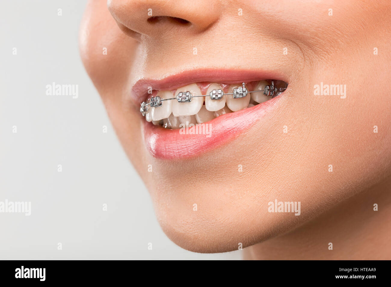 Beautiful young woman with teeth braces Stock Photo - Alamy