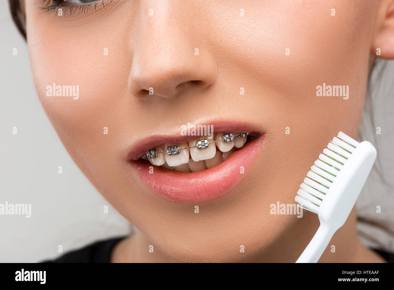 Beautiful young woman with teeth braces Stock Photo - Alamy