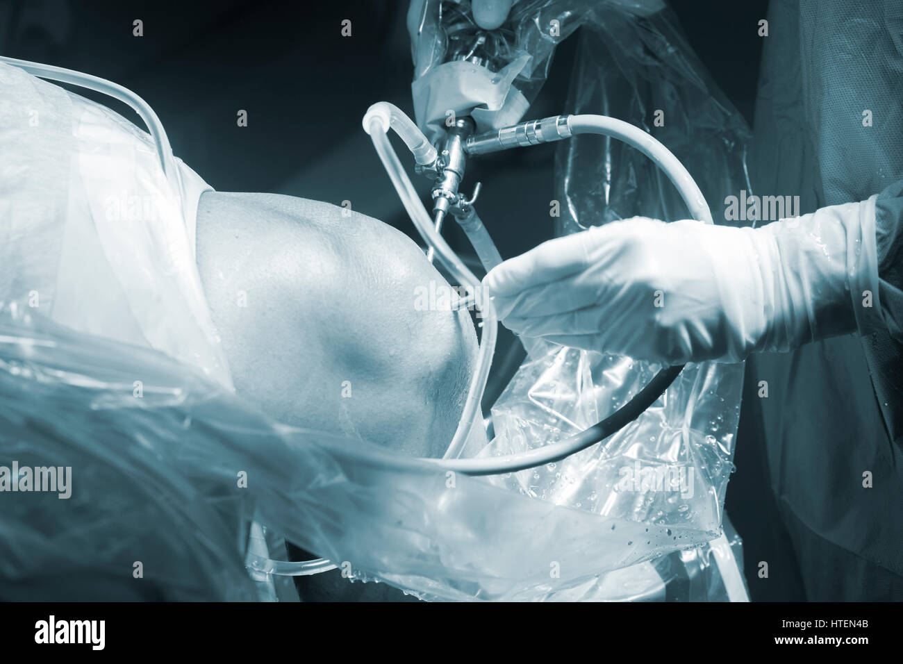 Knee keyhole surgery hospital arthroscopy operation medical procedure ...