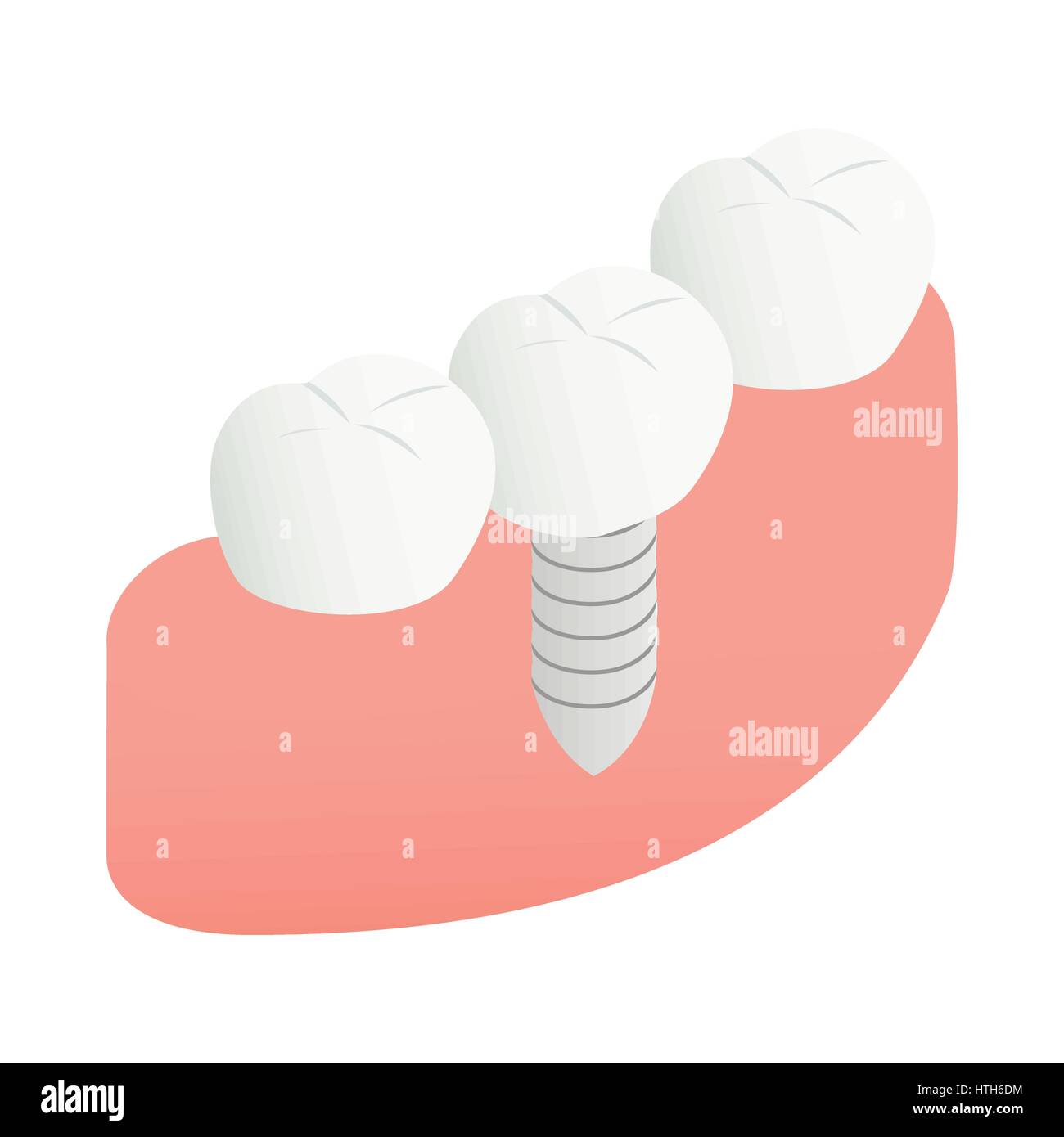 Tooth Implant icon, isometric 3d style Stock Vector Image & Art - Alamy