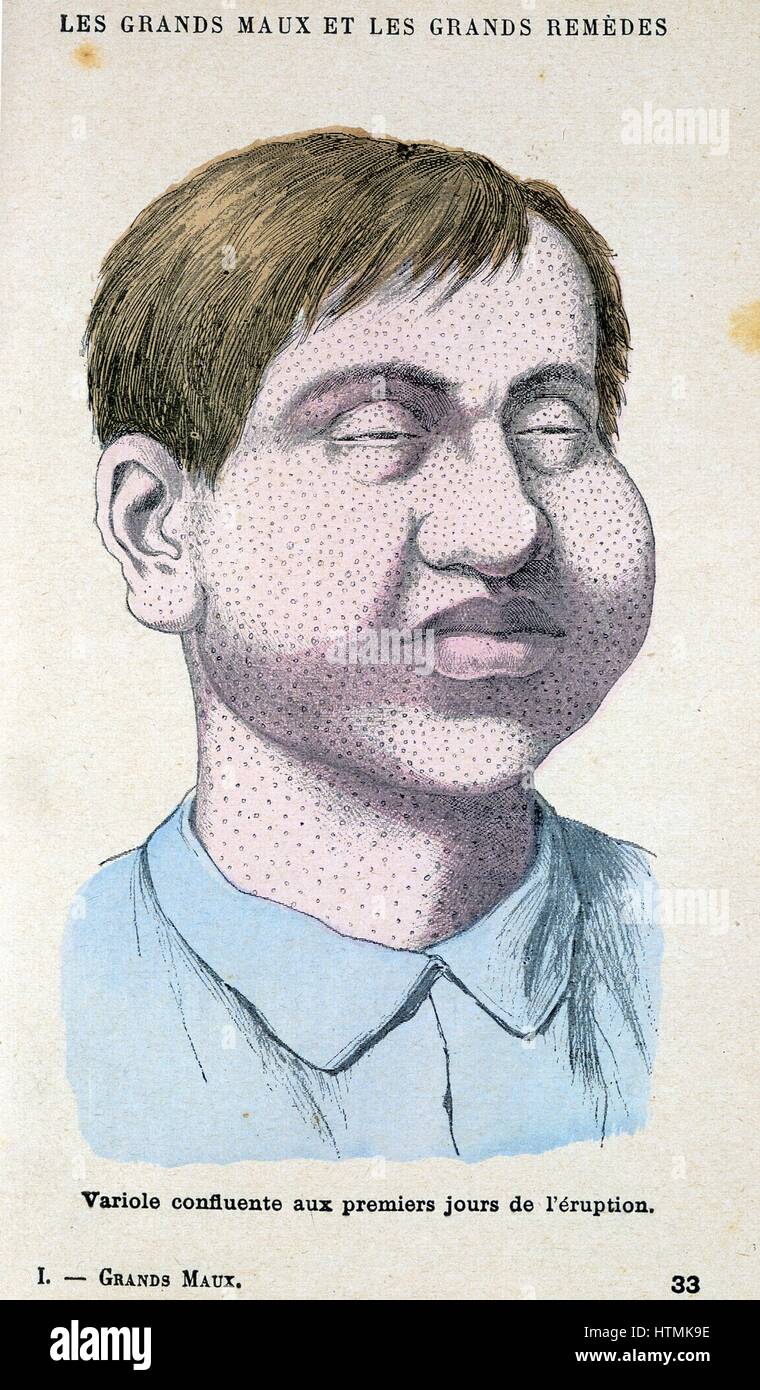 Smallpox victim hi-res stock photography and images - Alamy