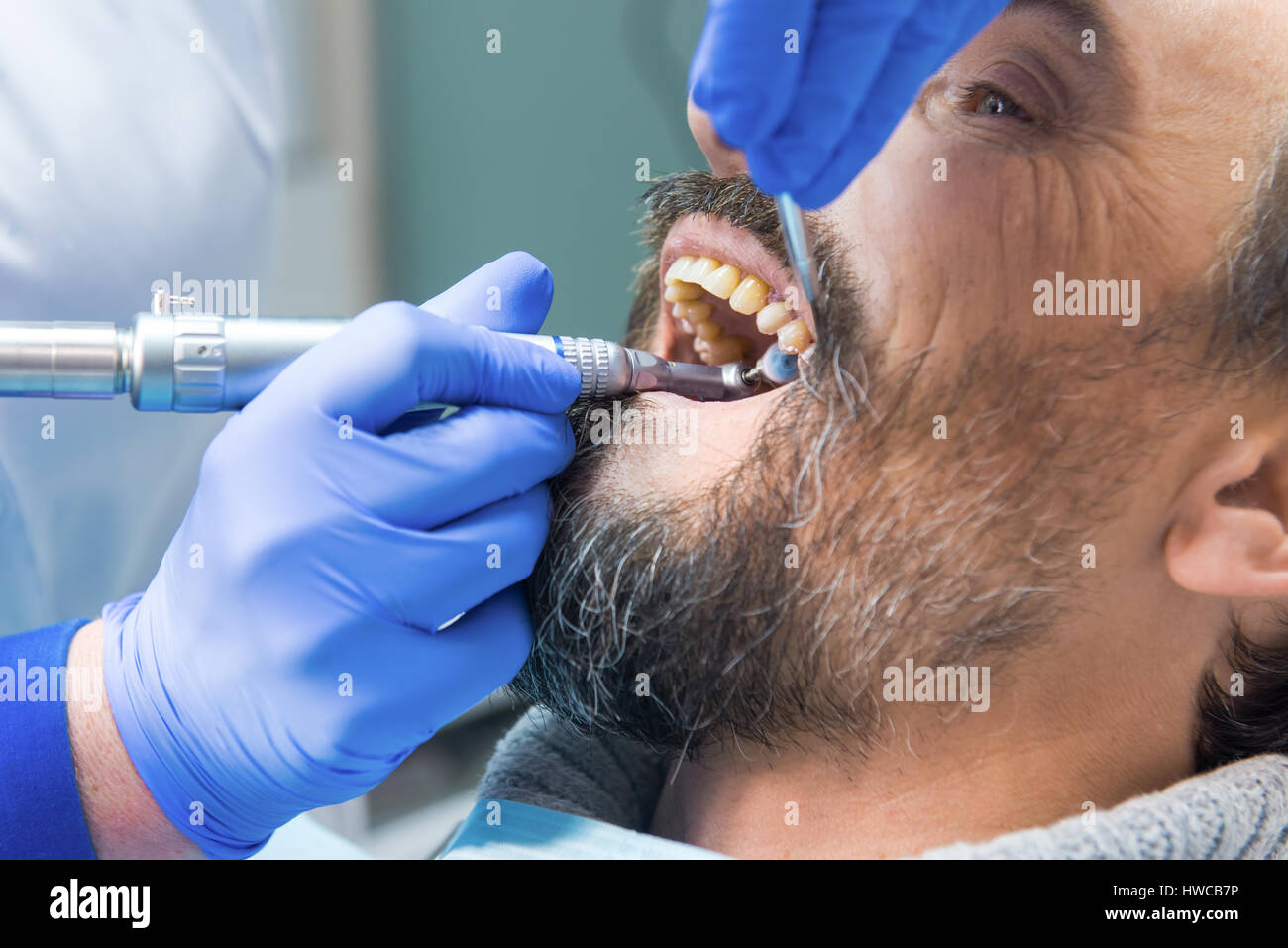 Dentist is cleaning teeth Stock Photo - Alamy